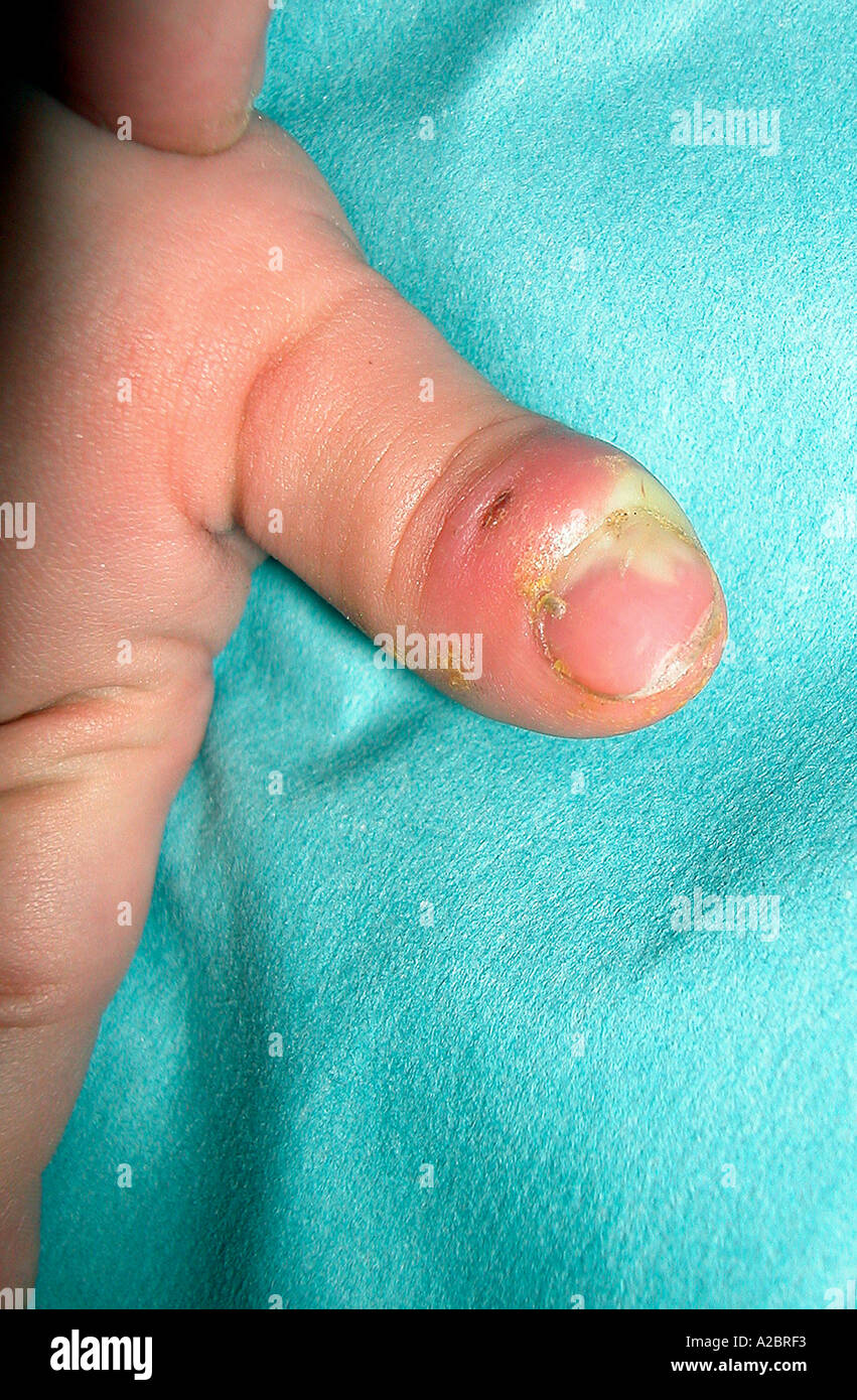 Paronychia infection hi-res stock photography and images - Alamy