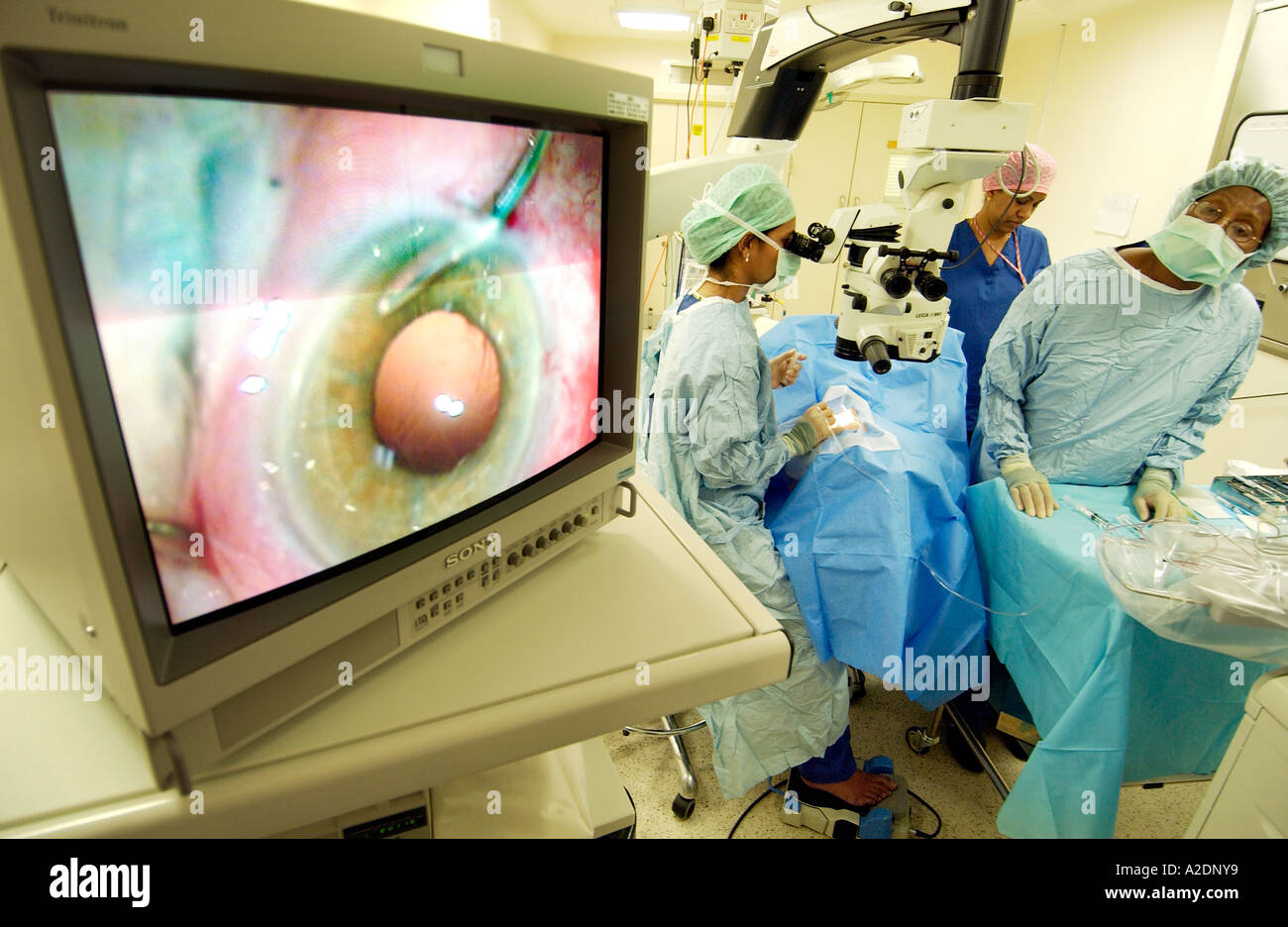 Cataract operation seen in close up on operating theatre screen with ...