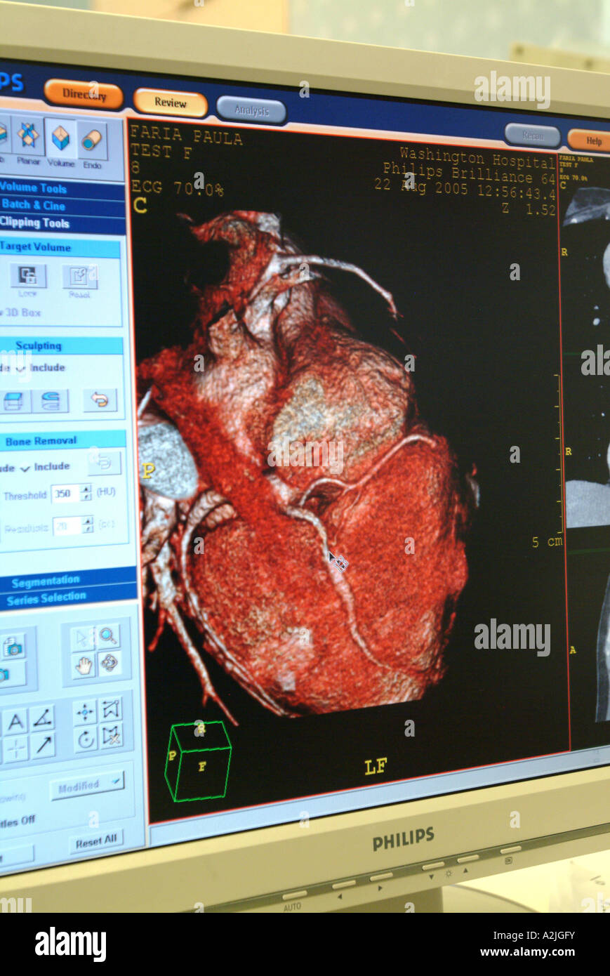 Mri heart scan hi-res stock photography and images - Alamy