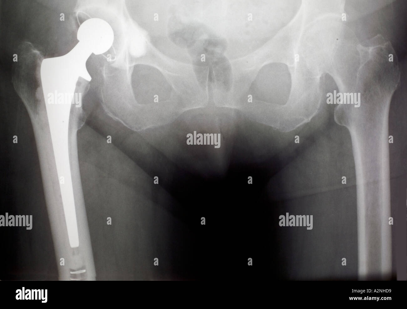 Hip replacement x ray hi-res stock photography and images - Alamy