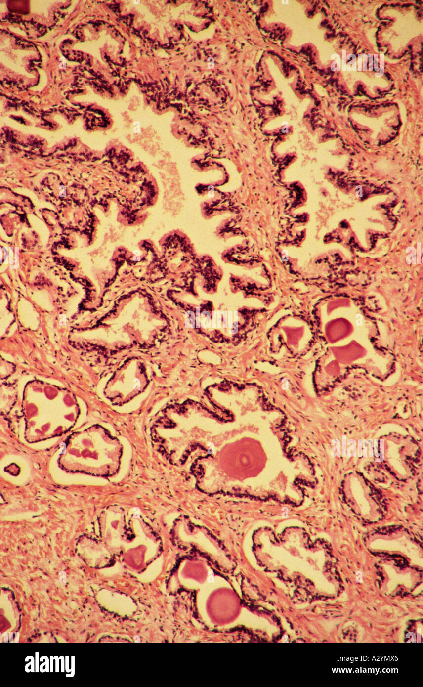 Microscopic prostate hi-res stock photography and images - Alamy