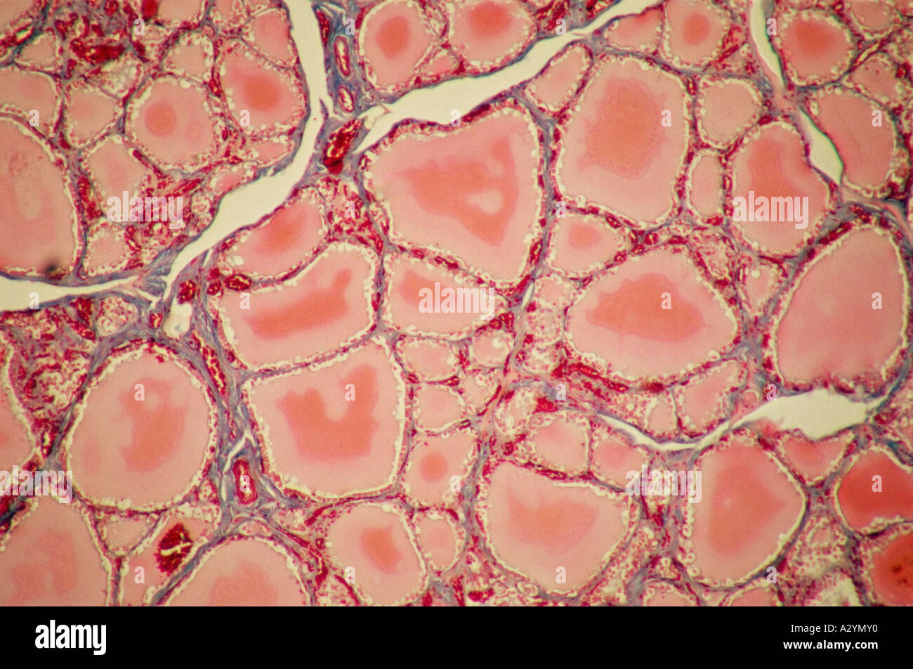 Follicular Colloid Of Thyroid