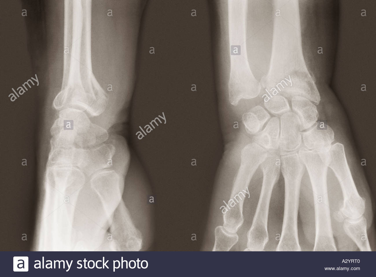 Fractured Arms Stock Photos & Fractured Arms Stock Images - Alamy