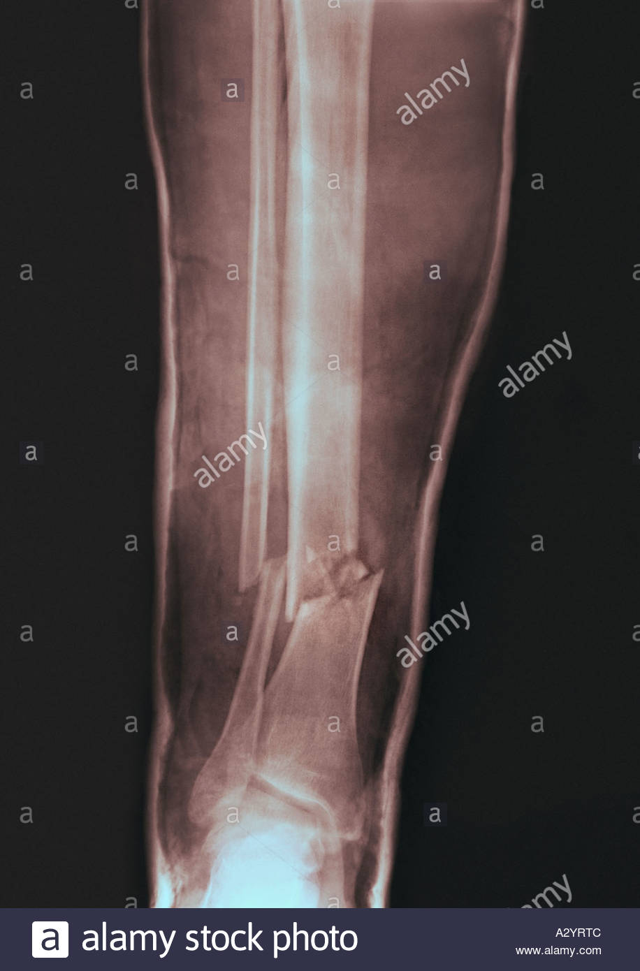 Fractured Tibia Stock Photos & Fractured Tibia Stock Images - Alamy