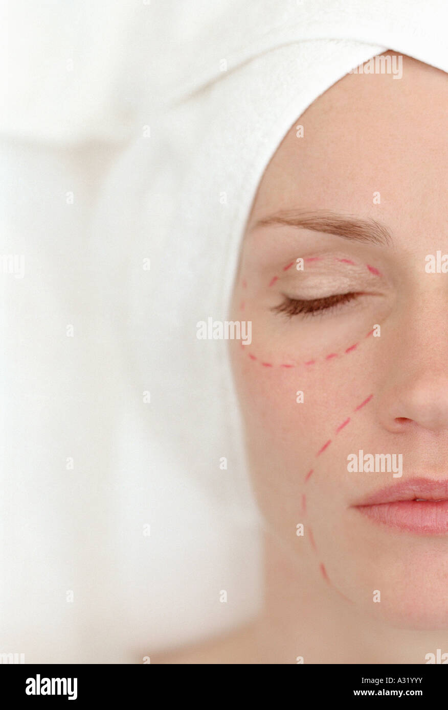 Woman with markings on face in preparation for plastic surgery Stock ...