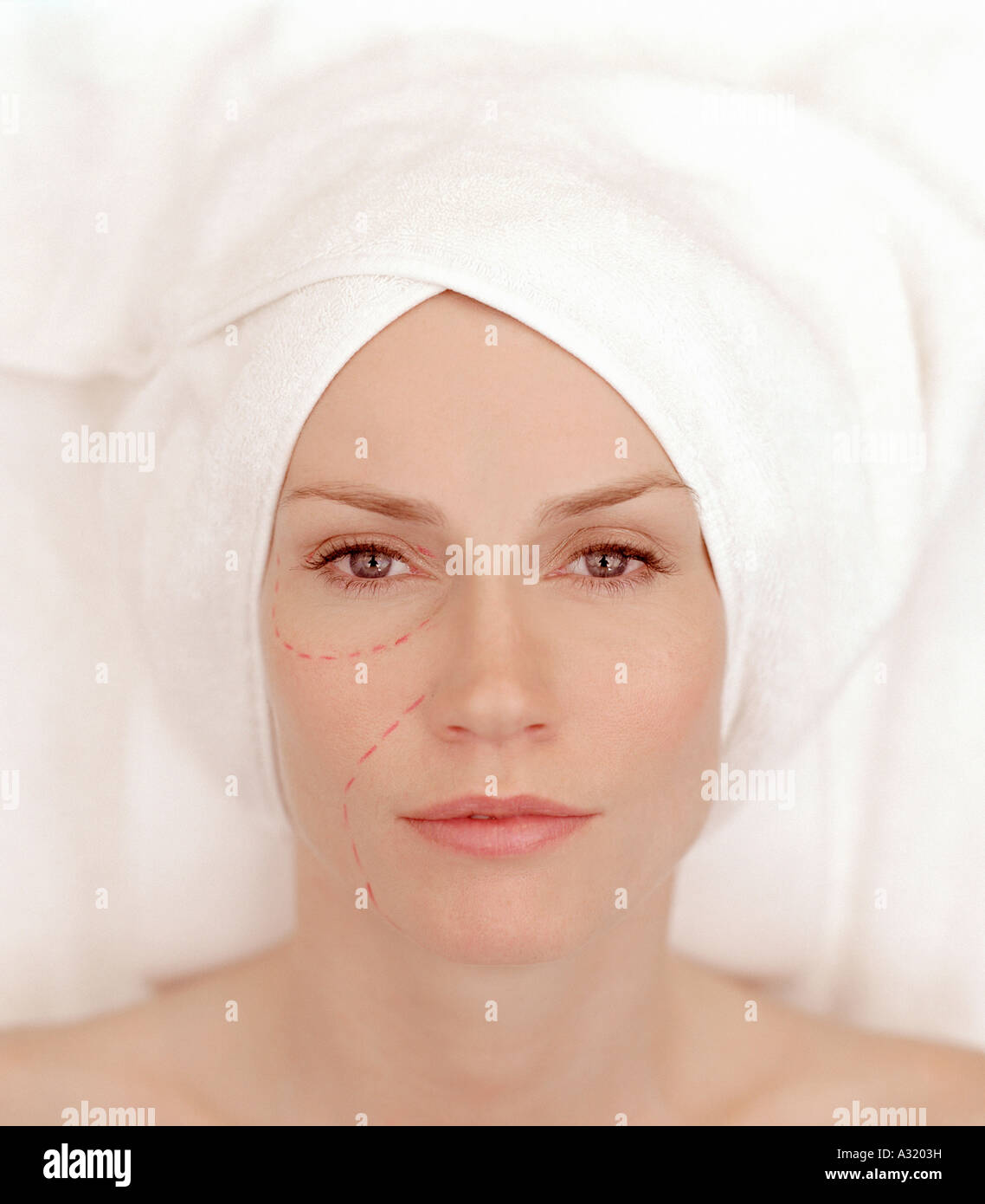 Woman with markings on face in preparation for plastic surgery Stock ...