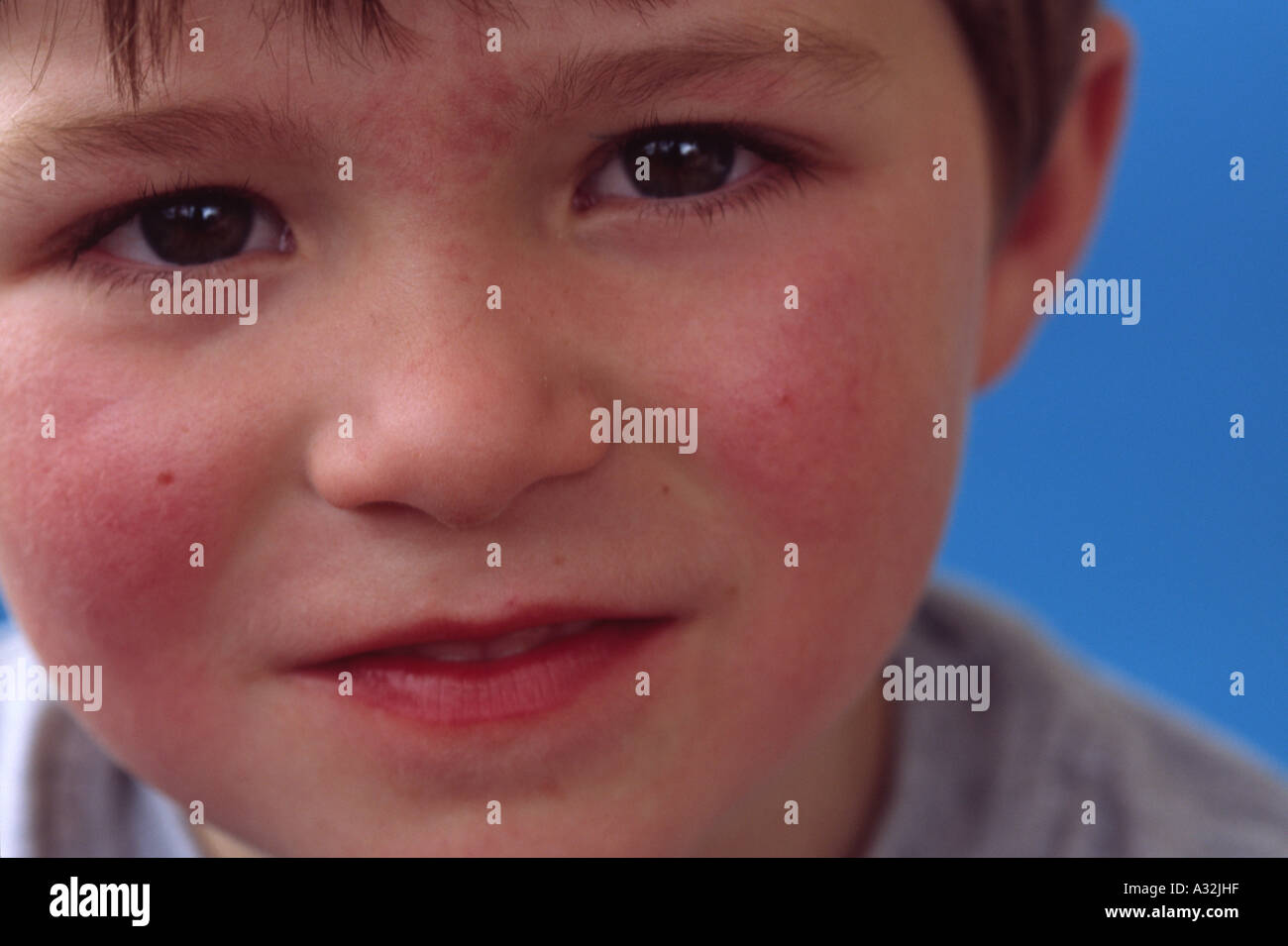 Ruddy complexion hi-res stock photography and images - Alamy