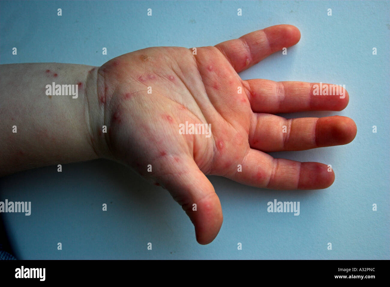 Small pox virus hi-res stock photography and images - Alamy