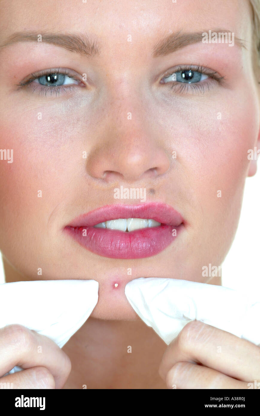 Pimples express hi-res stock photography and images - Alamy