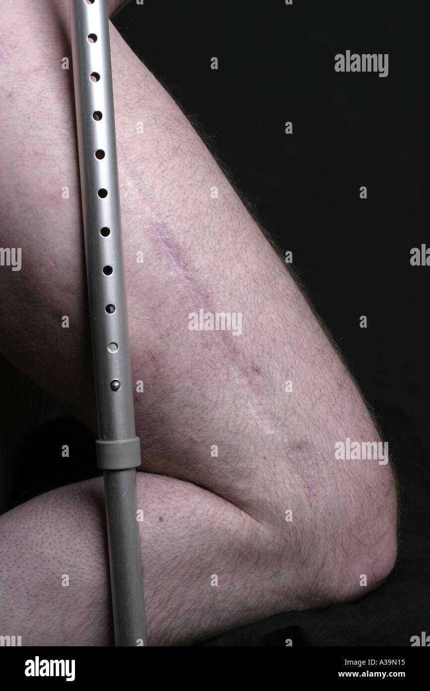Scars resulting from broken femur numerous operations bone ...