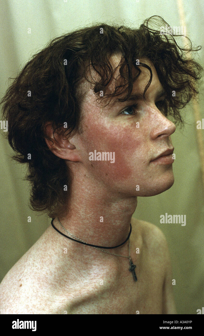 Scarlet fever rash hi-res stock photography and images - Alamy