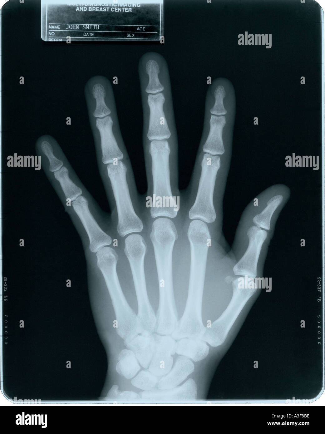 X ray of human hand Stock Photo - Alamy