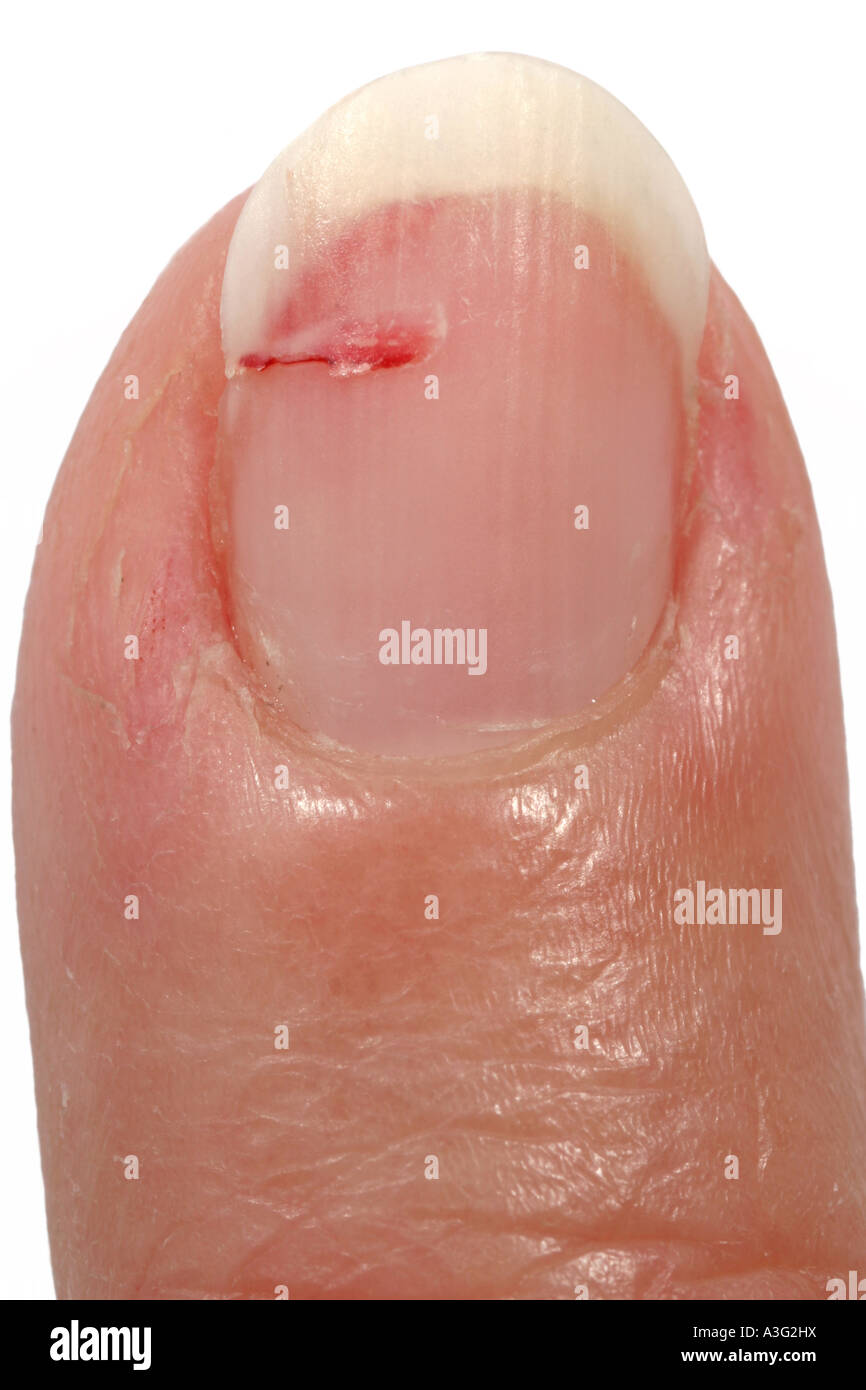 Broken finger nail hi-res stock photography and images - Alamy