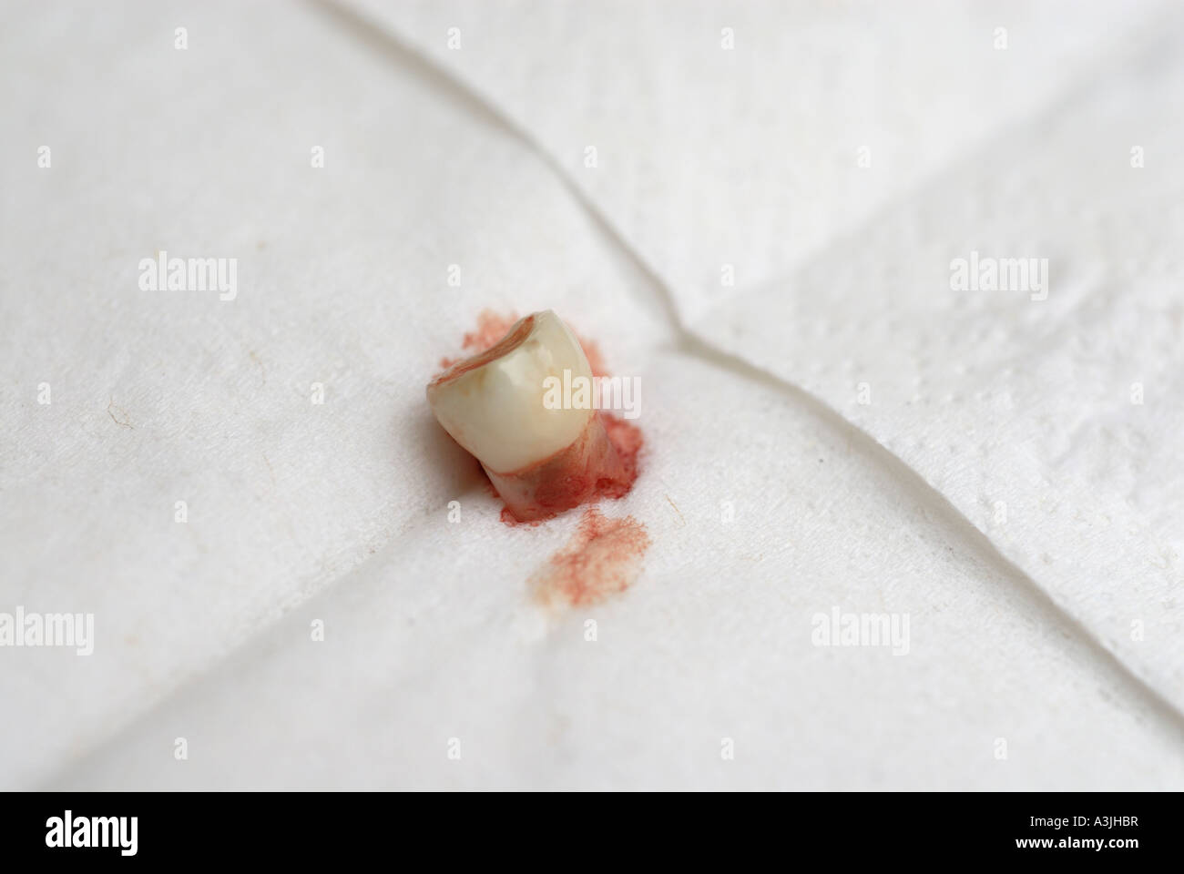 Falling out of tooth hi-res stock photography and images - Alamy
