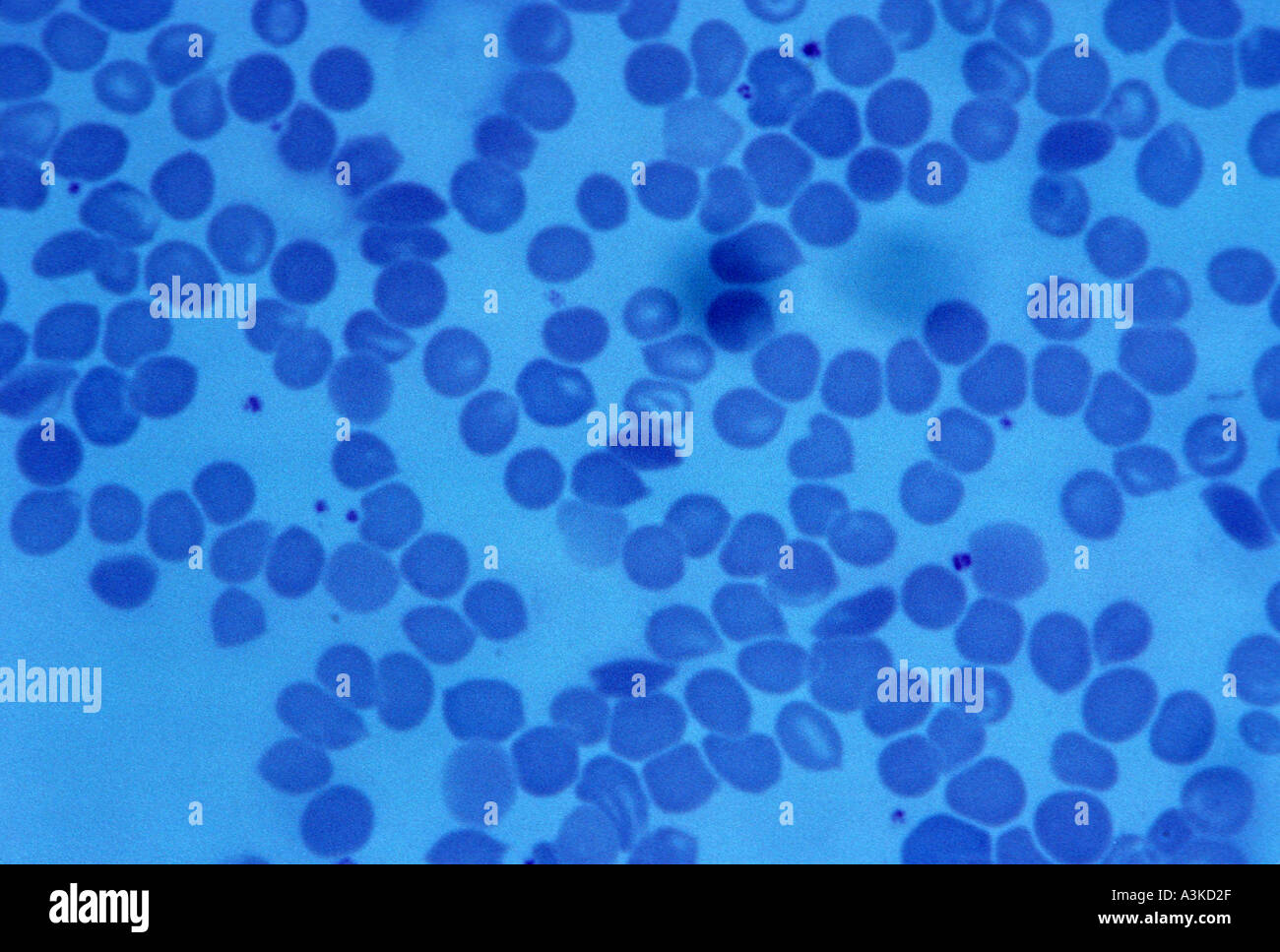 HUMAN Sickle-Cell Anemia 400X Stock Photo - Alamy