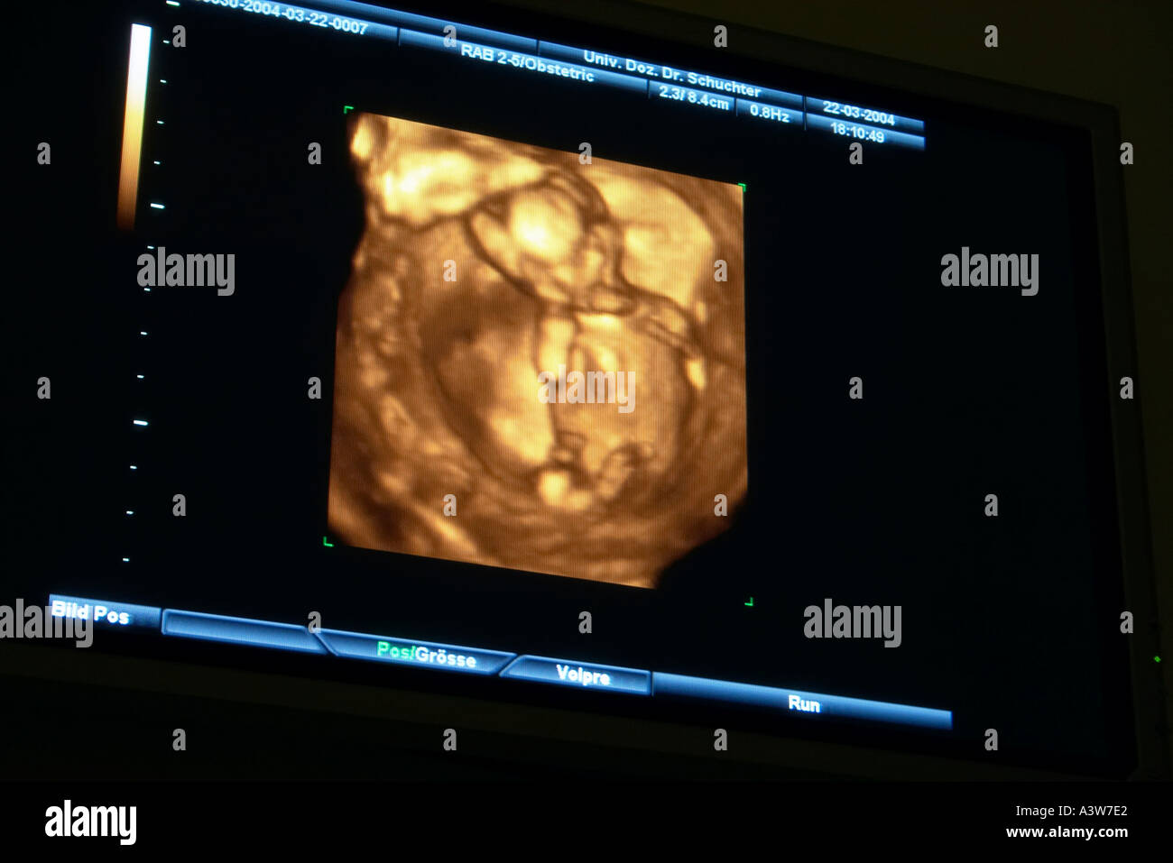 3D ultrasonic scan, 15th week Stock Photo - Alamy