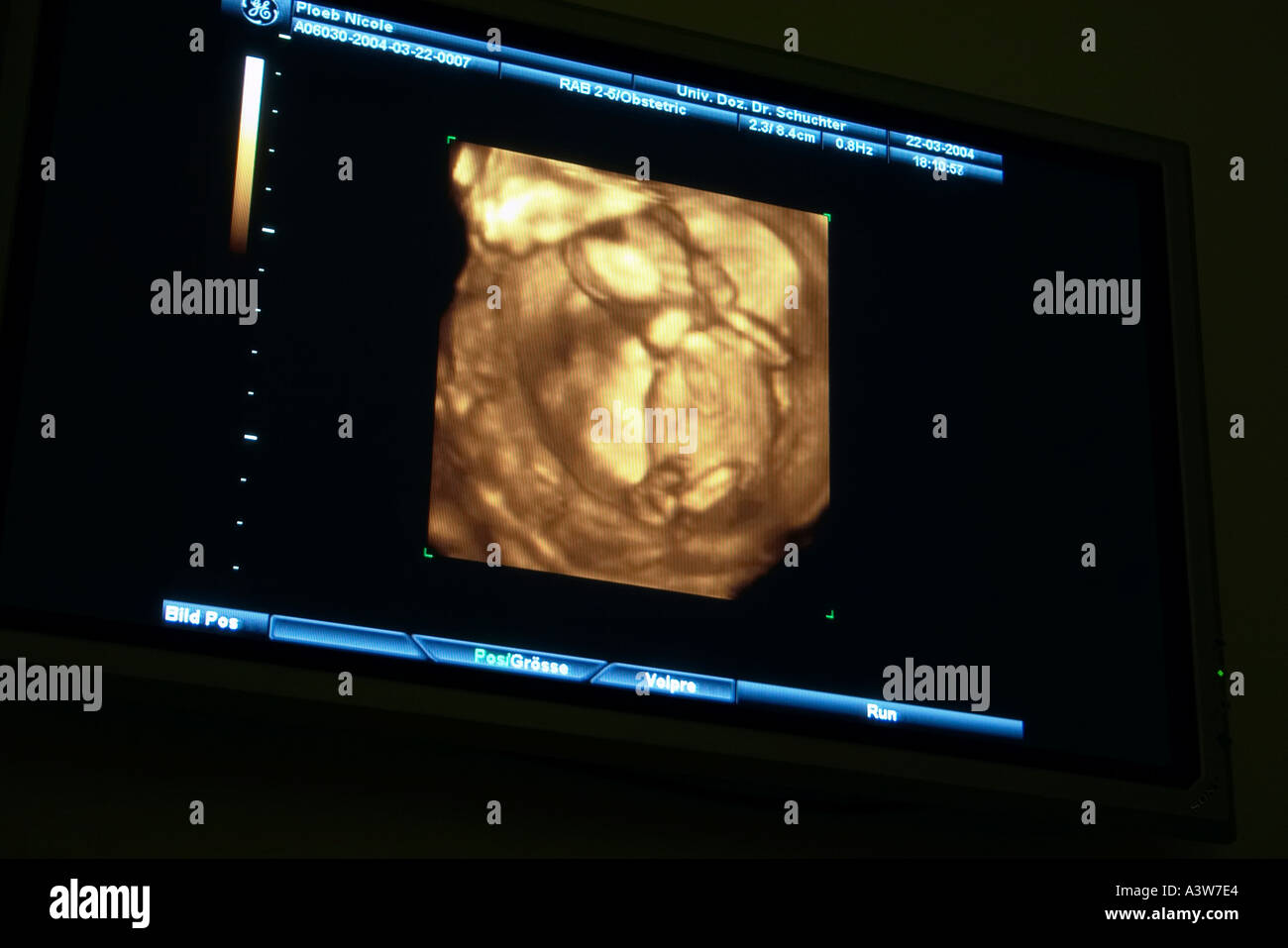 15 Week Ultrasound 3d