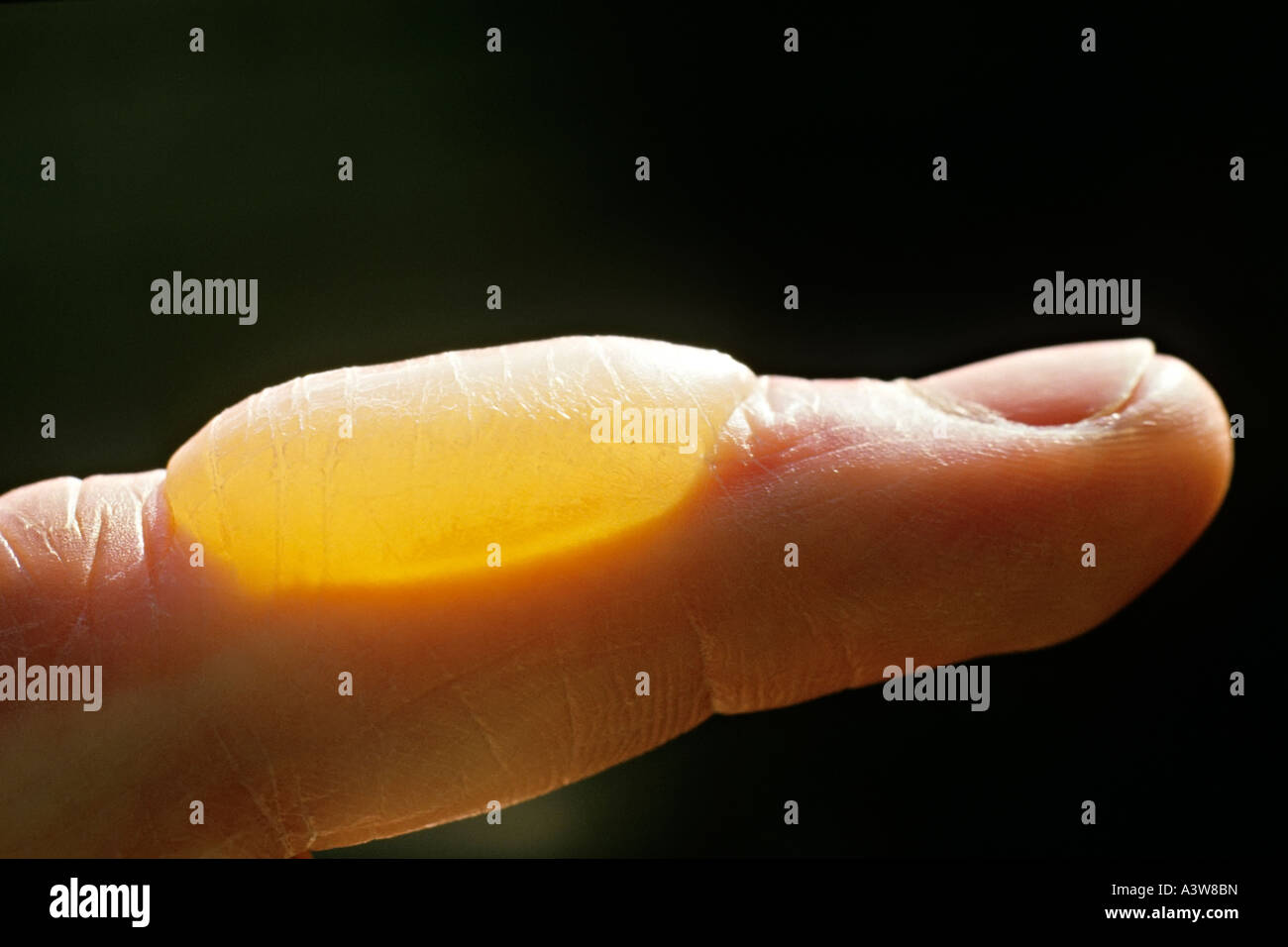 Burned finger hi-res stock photography and images - Alamy