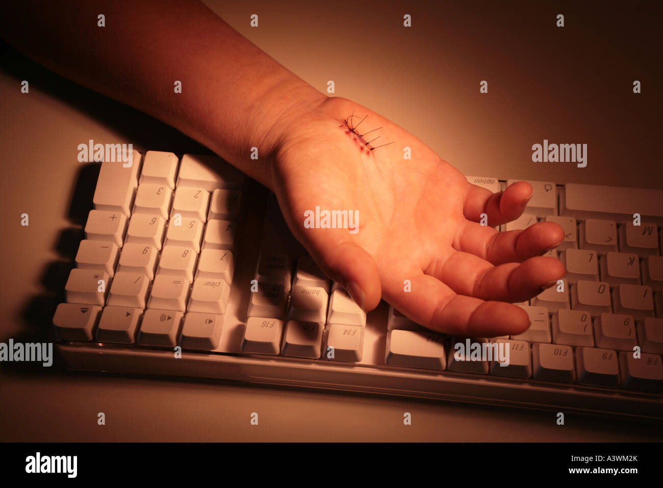 Hand resting on a computer keyboard with stitches in it from carpal ...