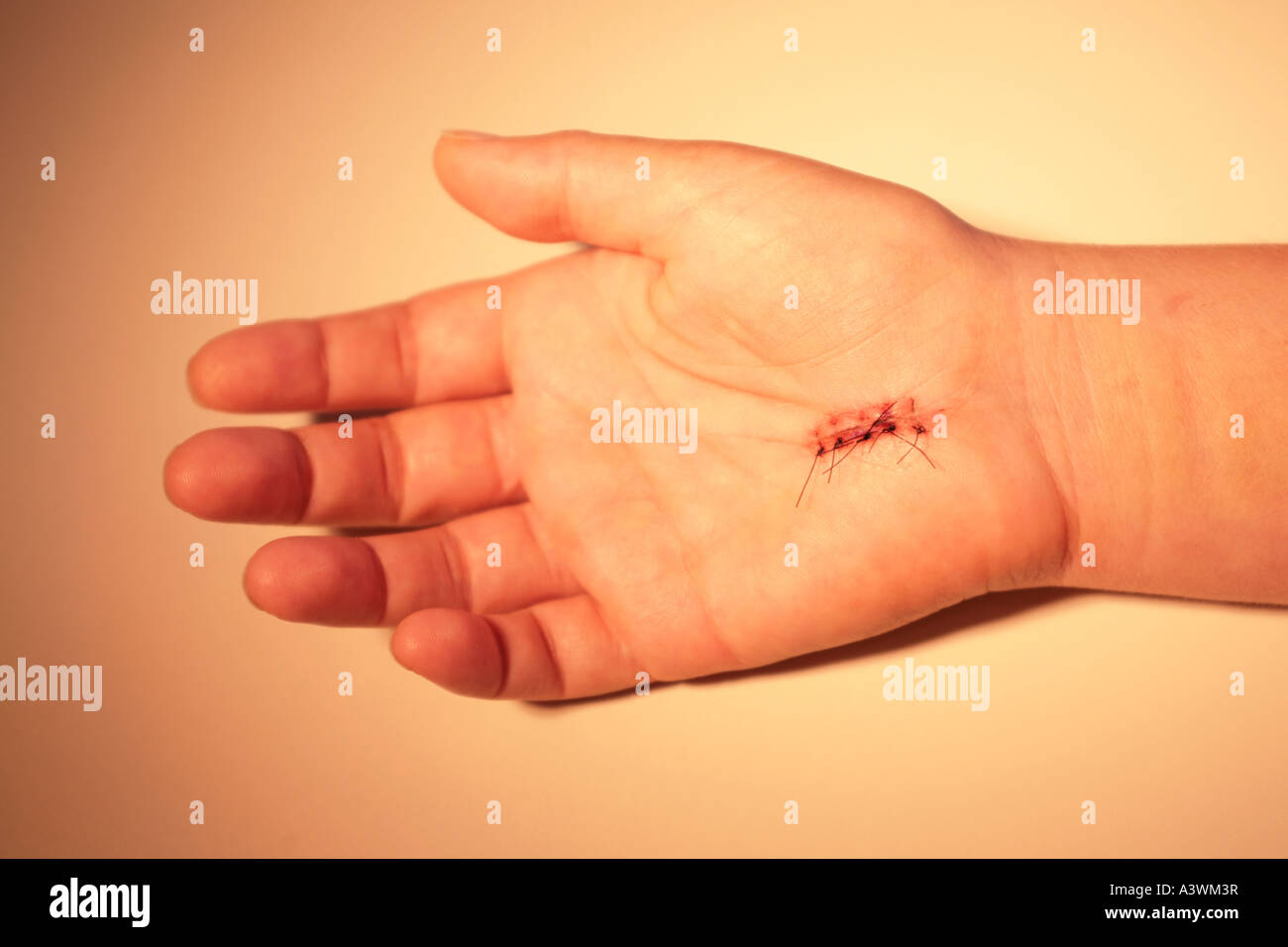 Hand with stitches from carpal tunnel surgery Stock Photo - Alamy