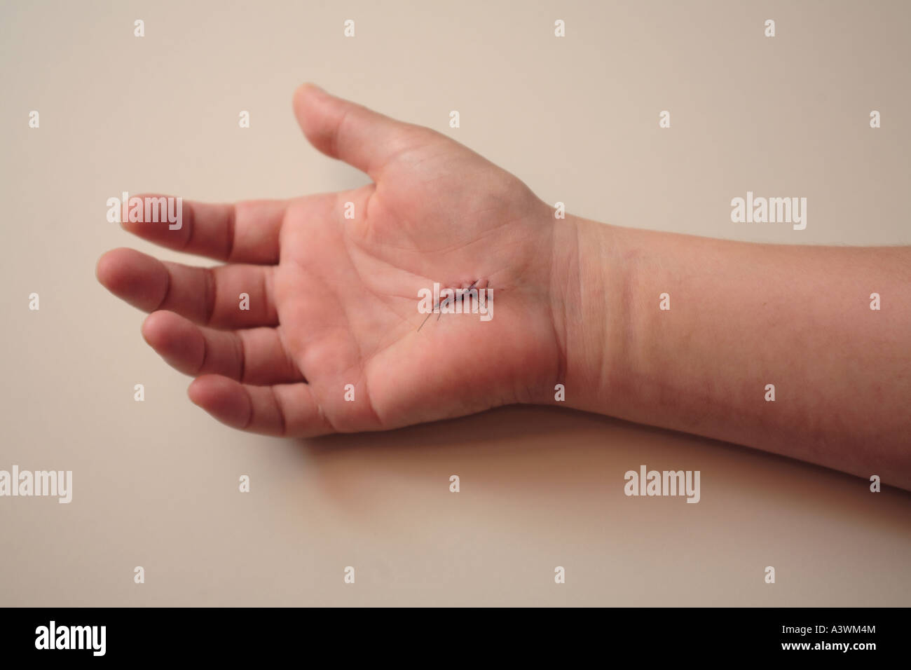 Hand with stitches from carpal tunnel surgery Stock Photo - Alamy