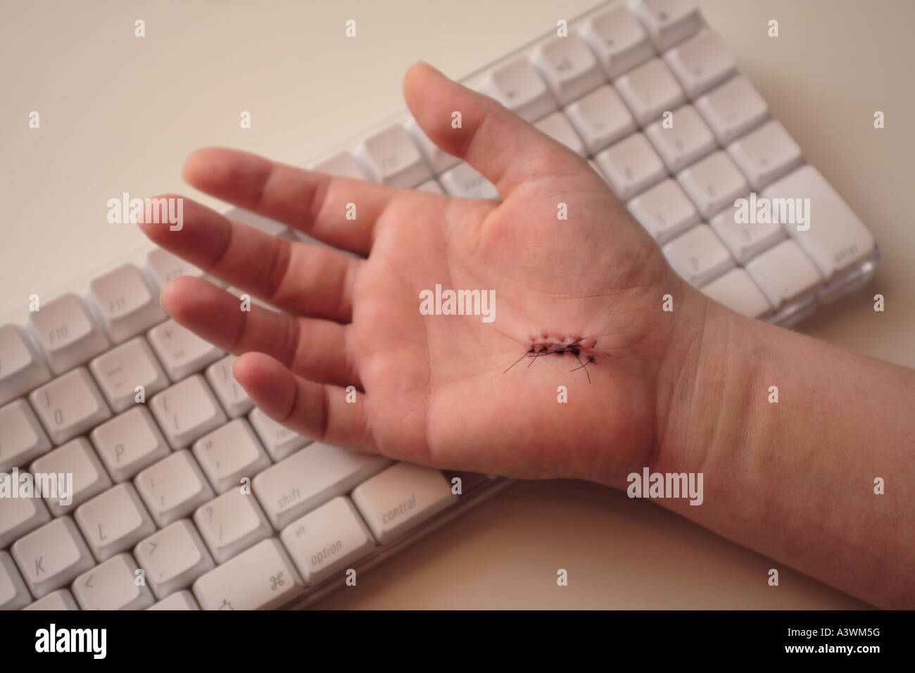 Hand resting on a computer keyboard with stitches in it from carpal ...