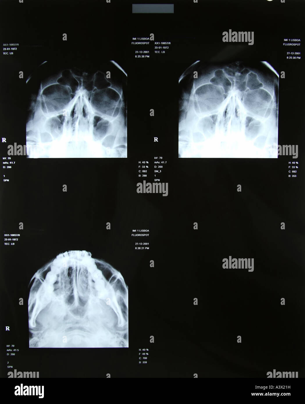 several sinus x rays in one plate with x ray data Stock Photo - Alamy