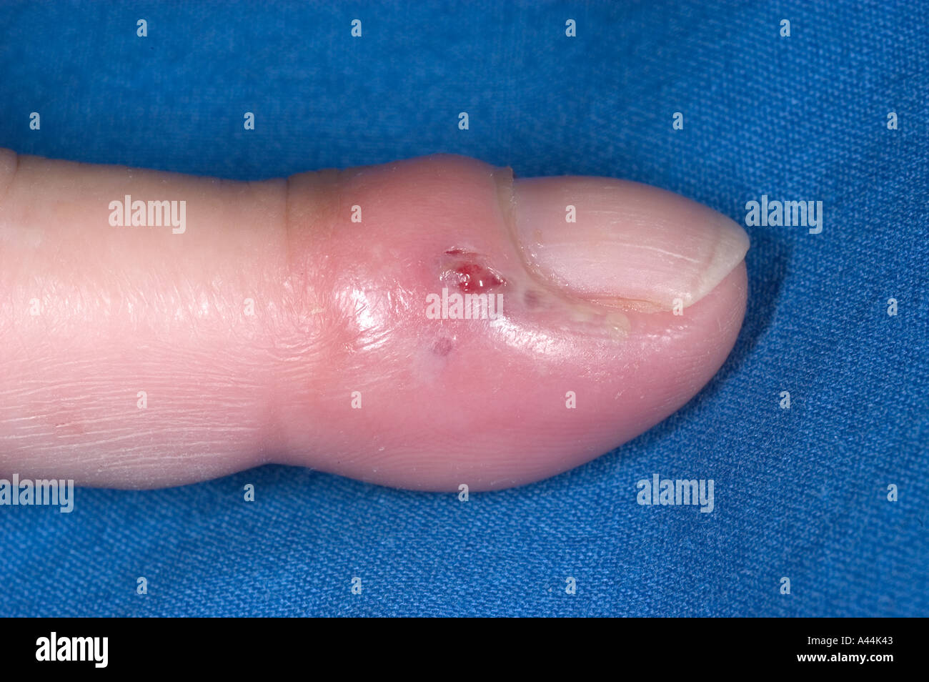 Herpetic Whitlow Pailme Self Inflicted Herpetic Whitlow | BMJ Case