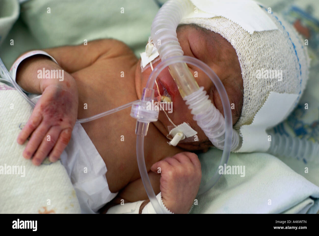 Premature infant care hi-res stock photography and images - Alamy