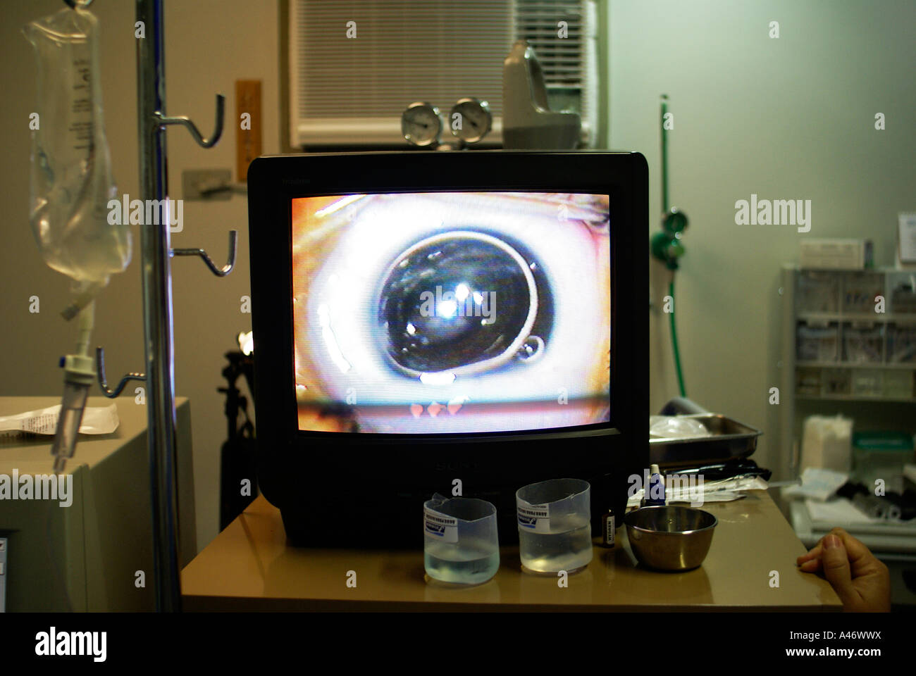 Cataract eye congenital hi-res stock photography and images - Alamy
