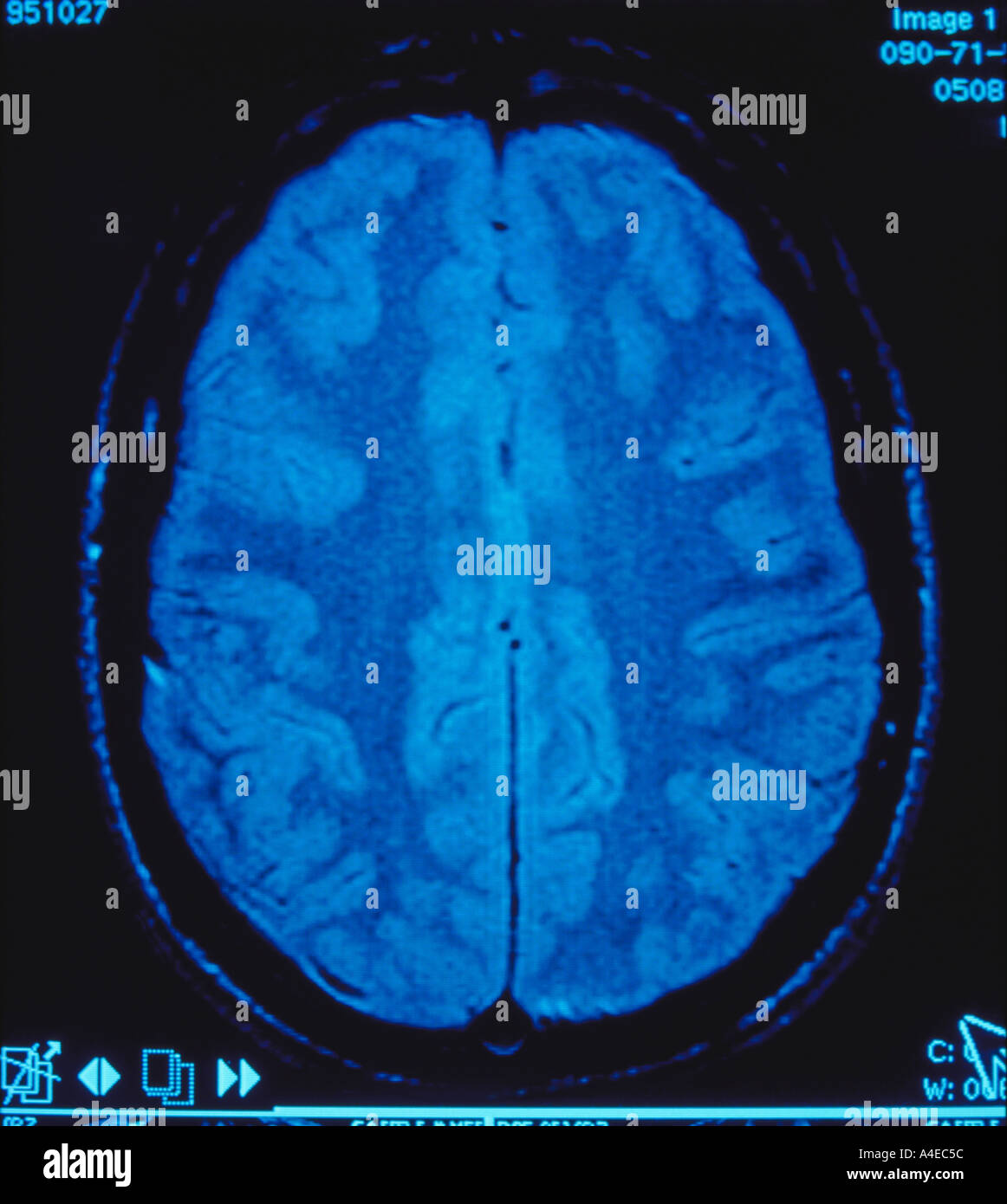 Normal MRI scan of human head top view Stock Photo - Alamy