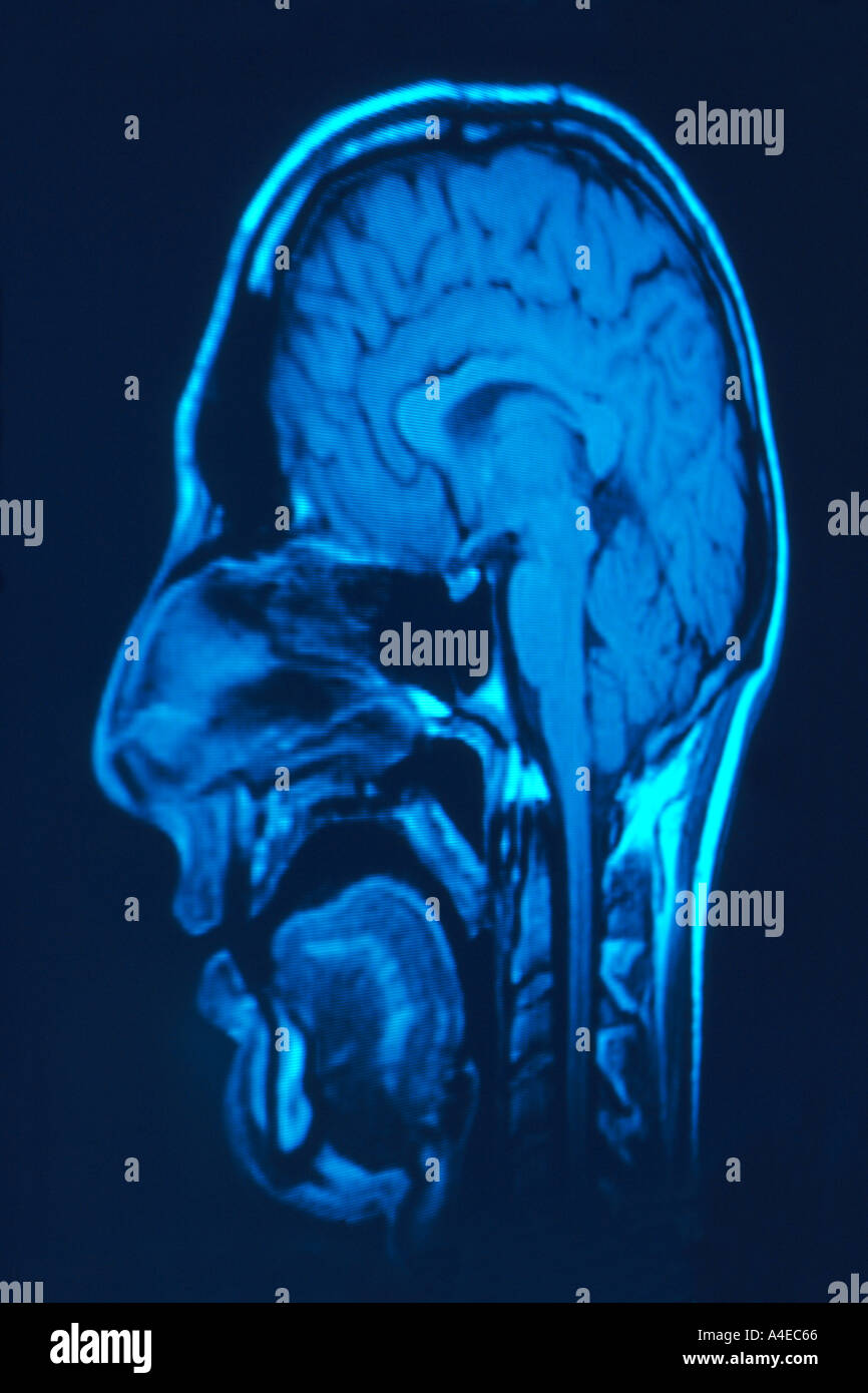 Normal brain mri hi-res stock photography and images - Alamy