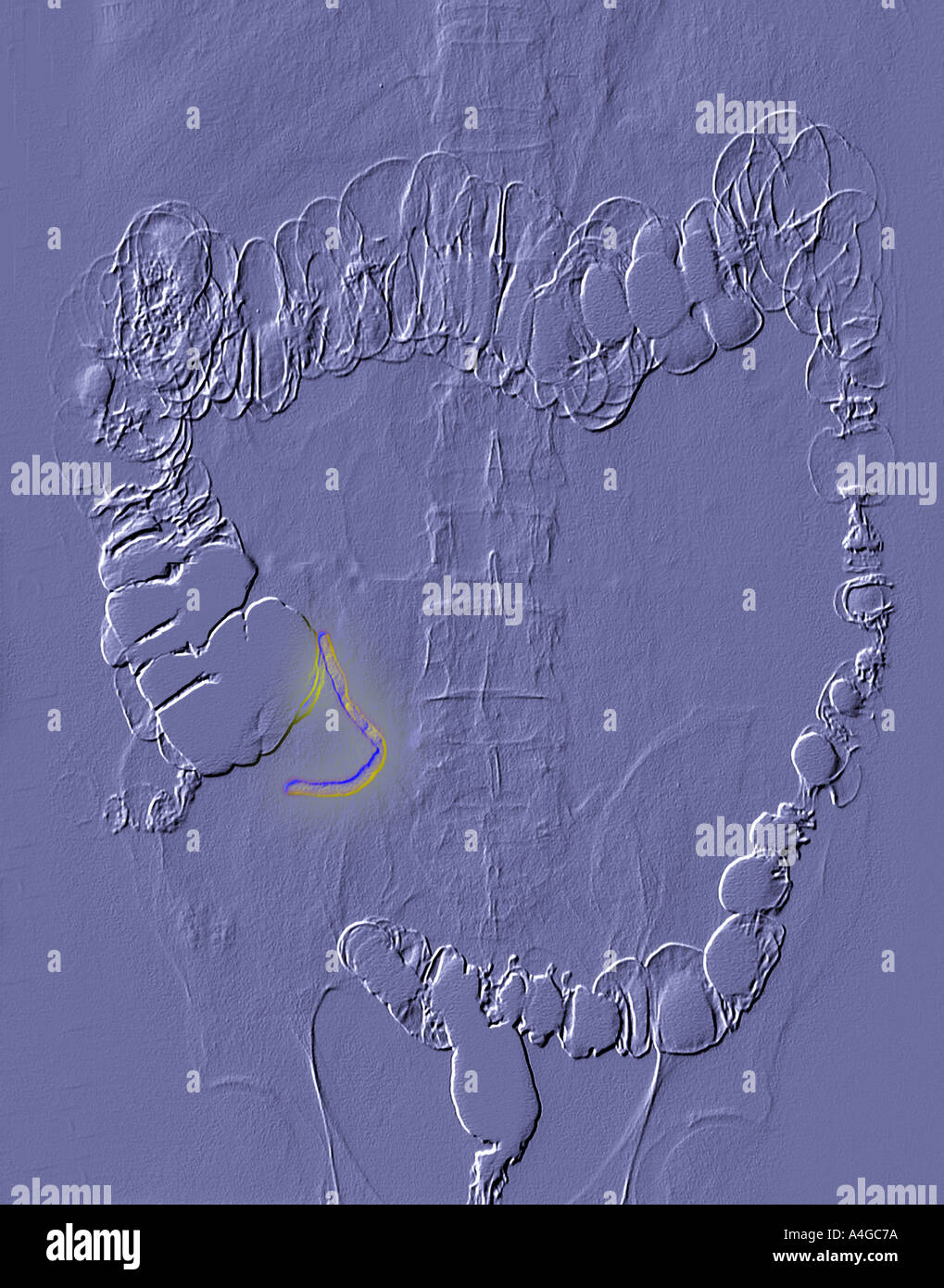 Barium enema xray showing appendix and diverticula highlighted in ...