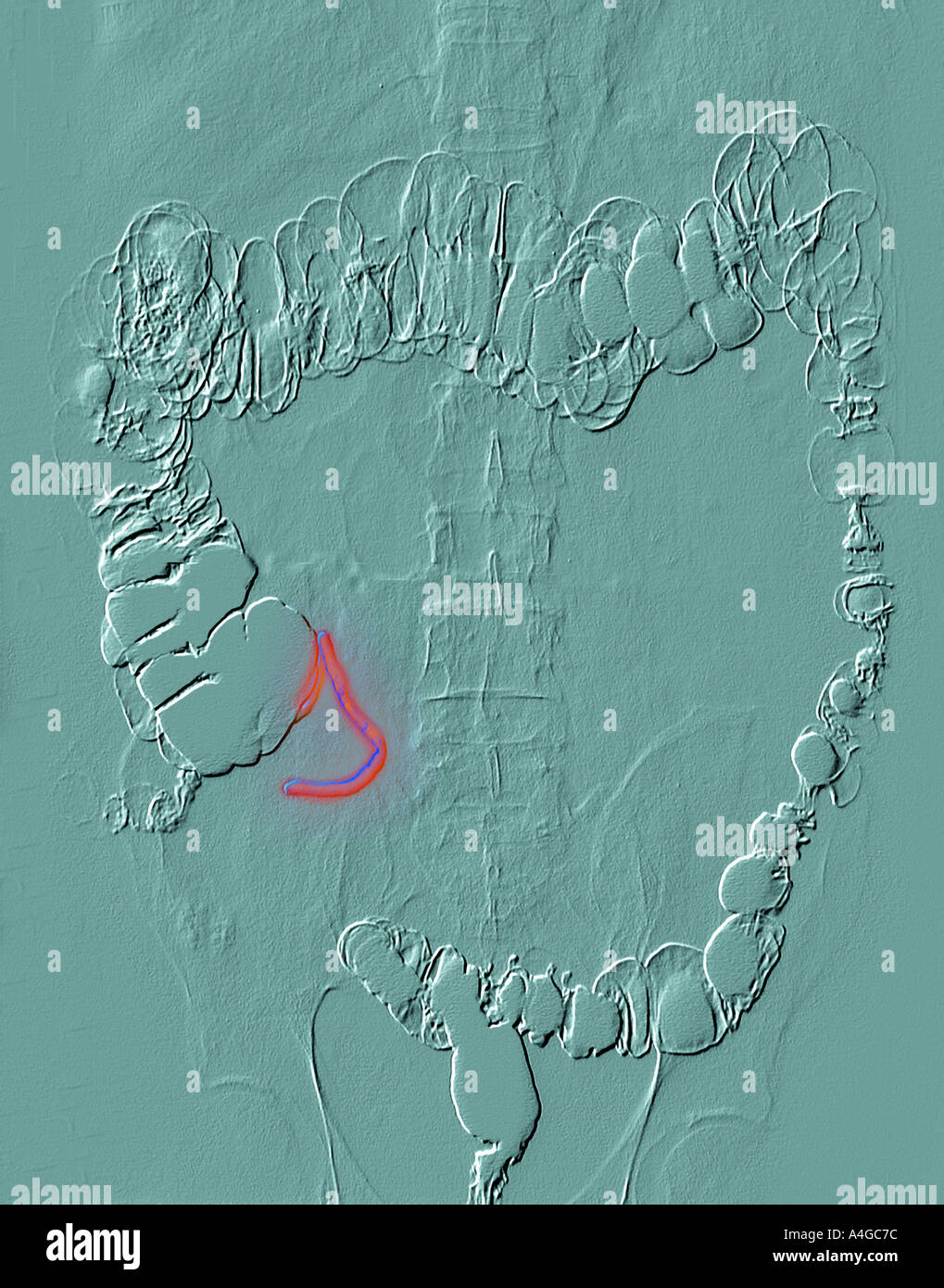 Barium enema xray showing appendix yellow and diverticula Stock Photo ...