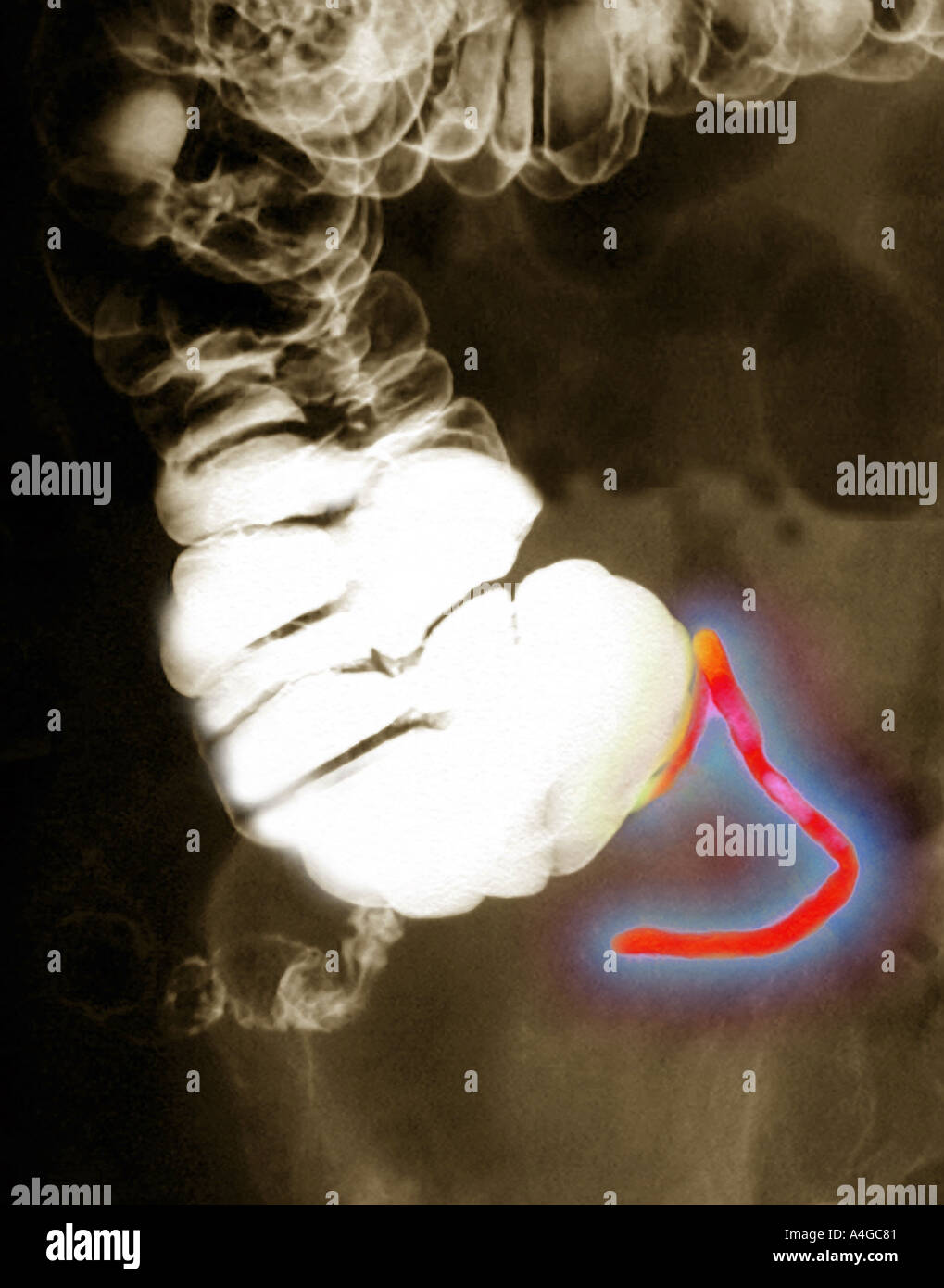 Barium Enema High Resolution Stock Photography and Images - Alamy