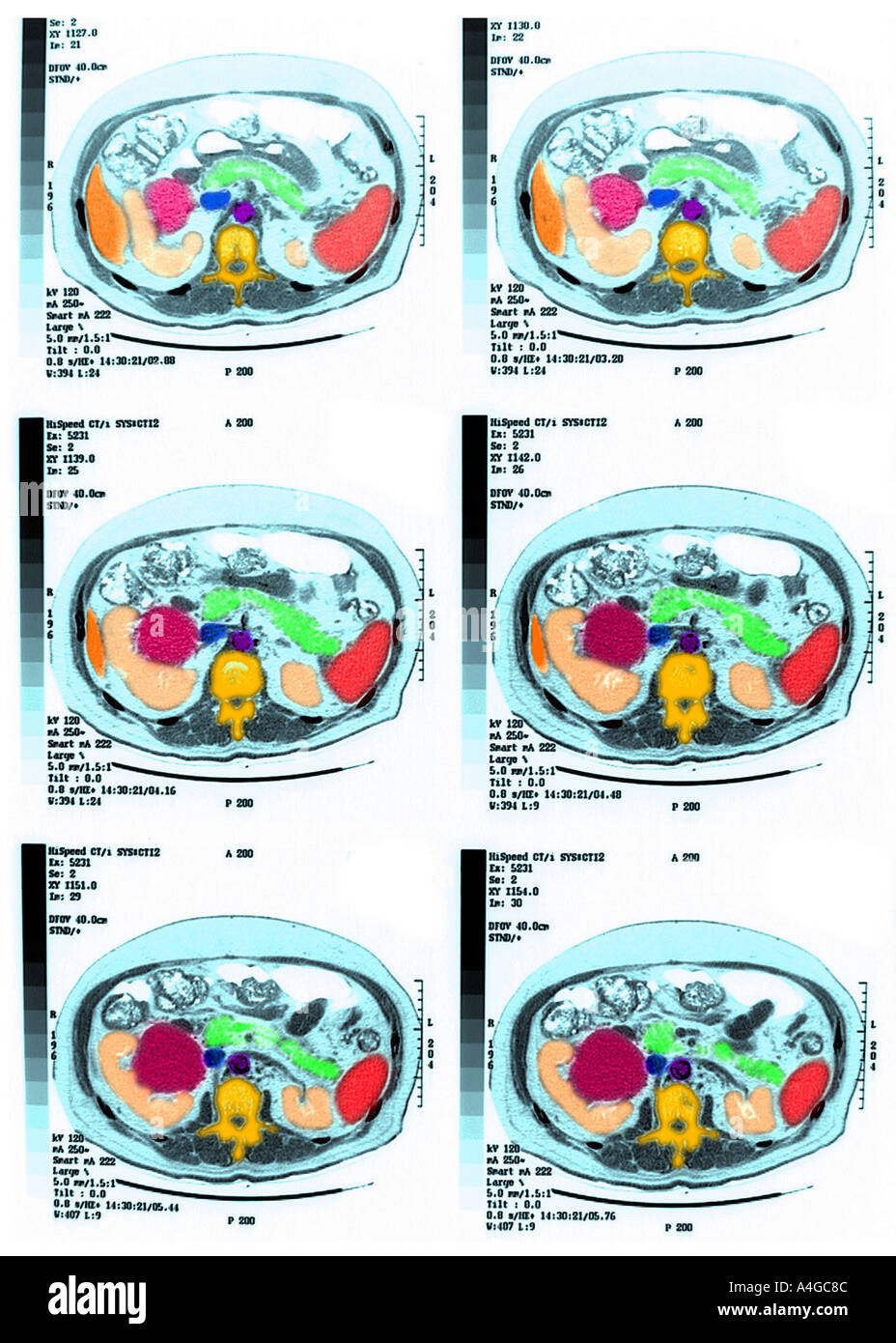 CT scan of a 78 year old male with a large cystic structure involving ...