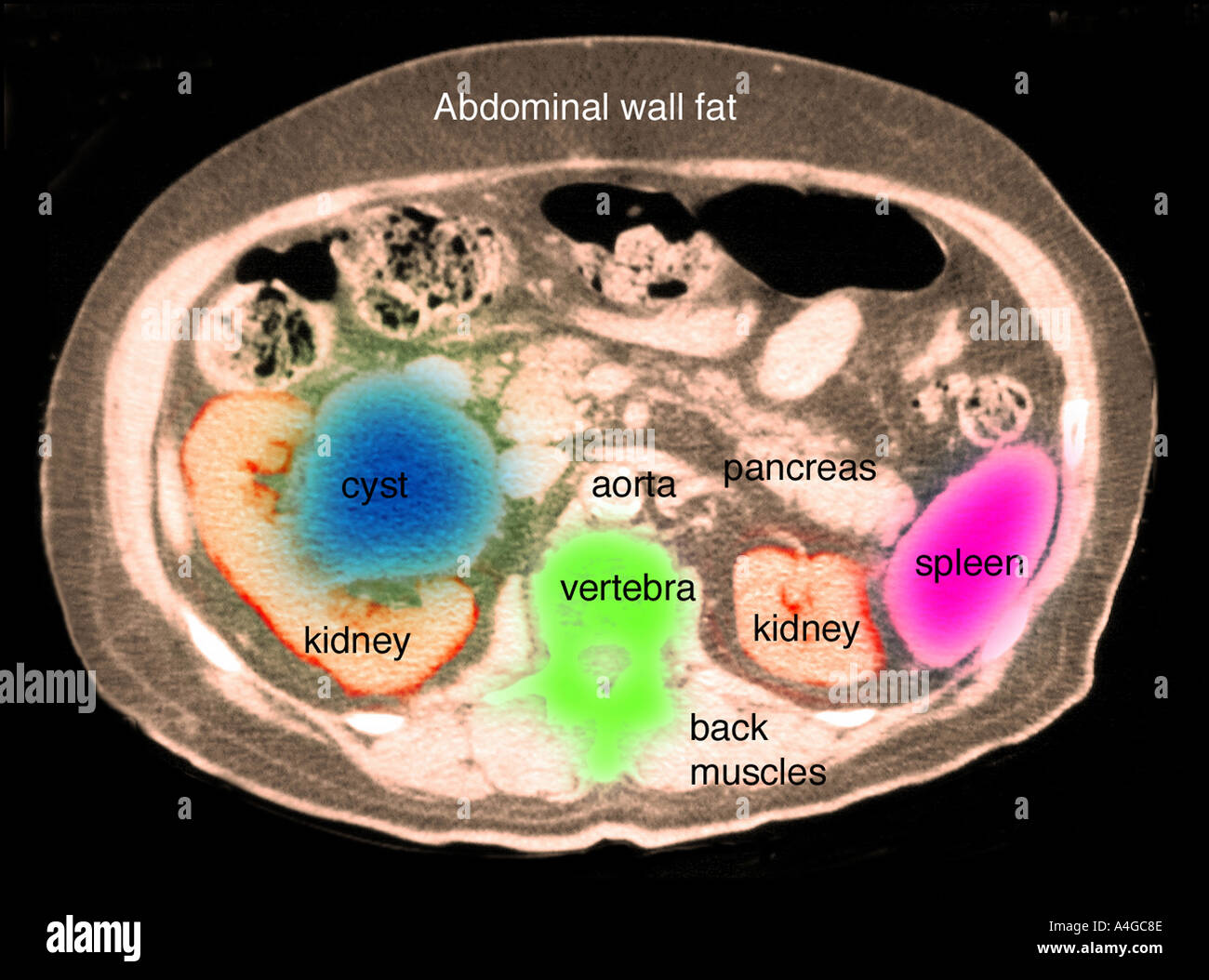 CT scan of a 78 year old male with a large cystic structure involving ...