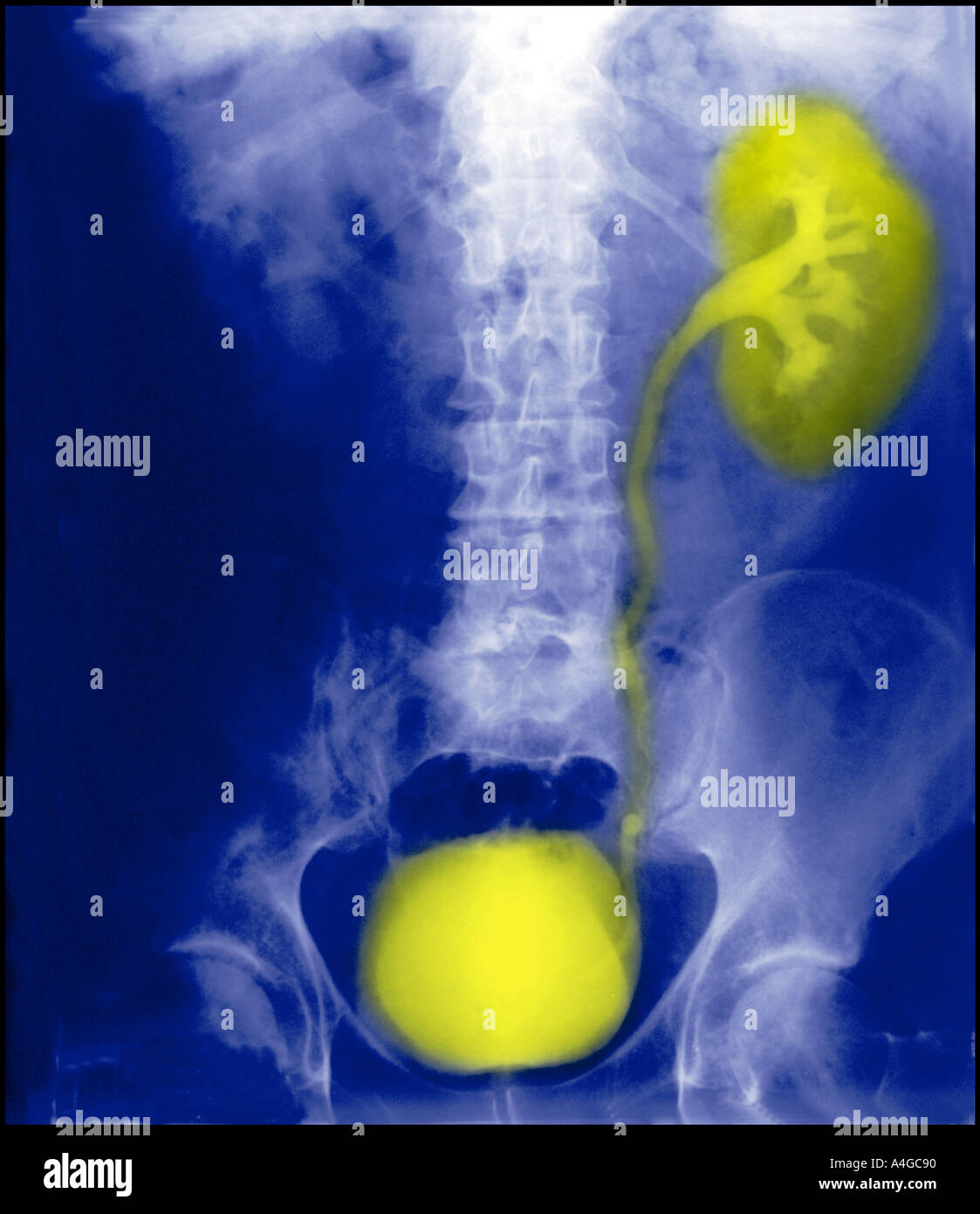 An IVP intravenous pyelogram showing obstruction of a kidney and ...