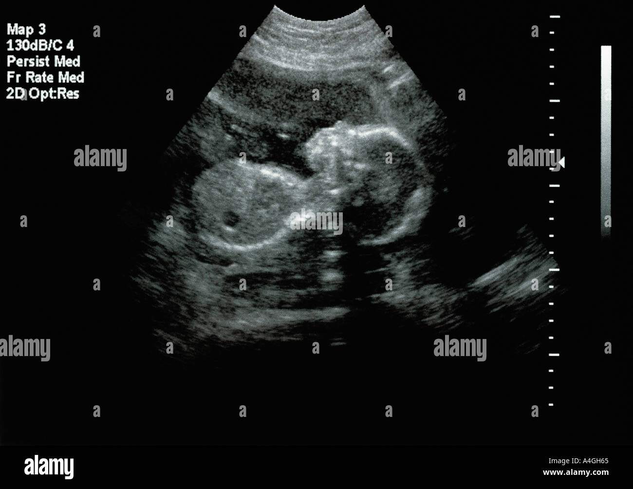 Baby in the womb hi-res stock photography and images - Alamy