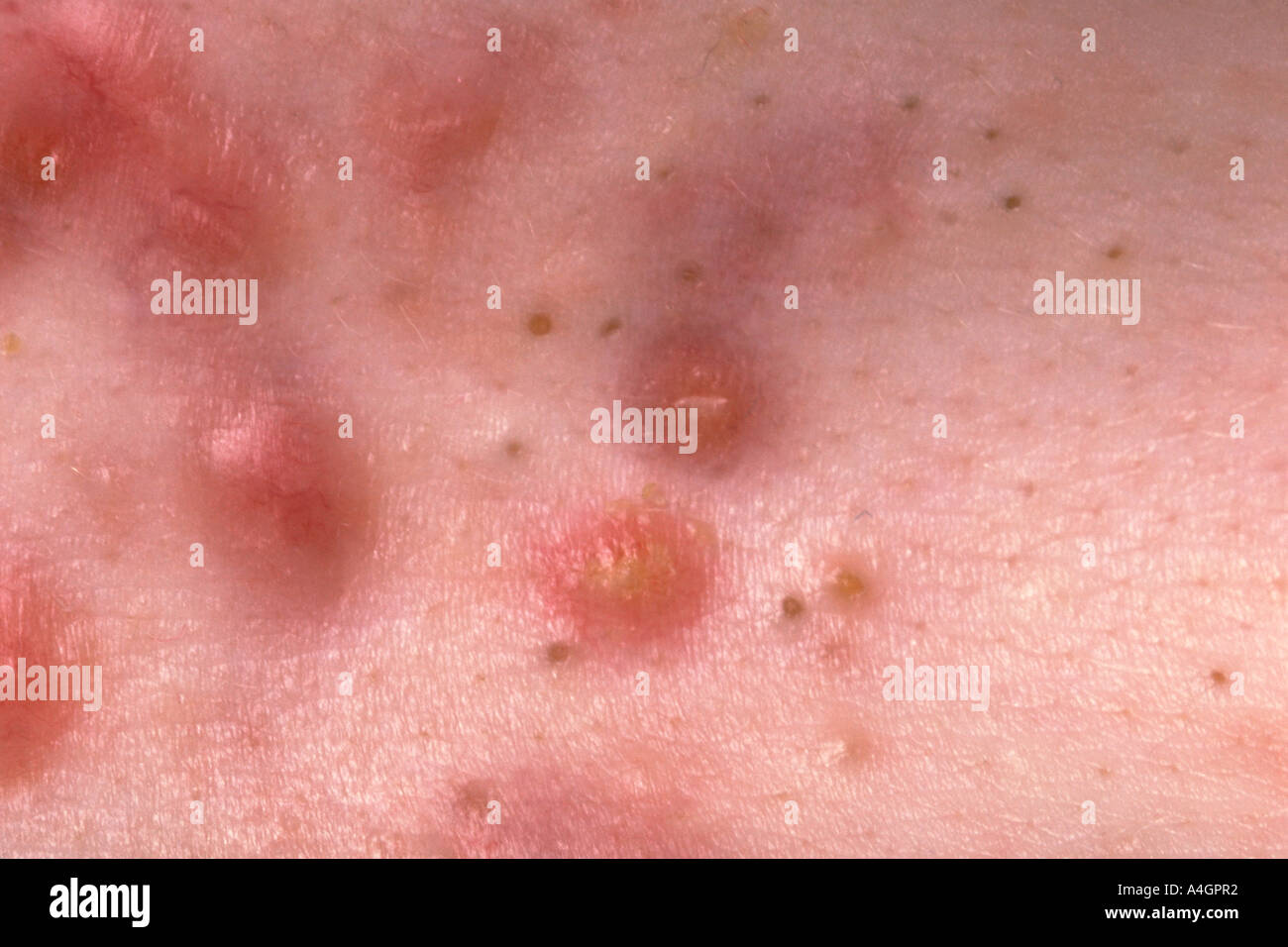 Keloid scarring hi-res stock photography and images - Alamy