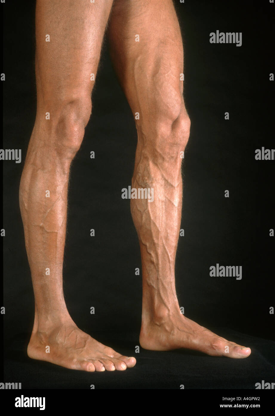 A photograph of a male with HIV associated lipodystrophy syndrome Stock ...