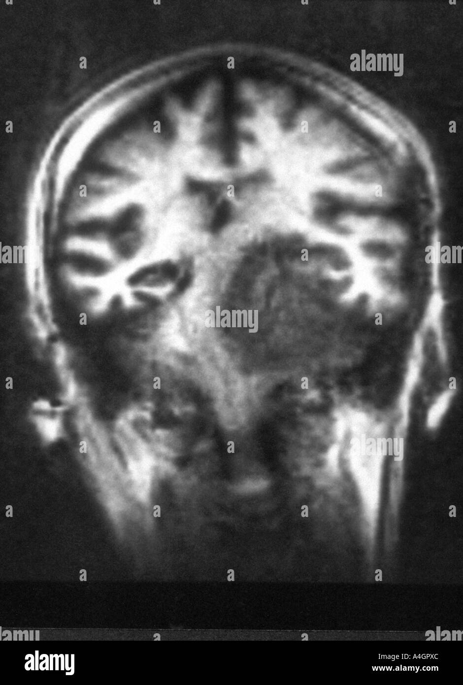 Benign brain mri Black and White Stock Photos & Images - Alamy