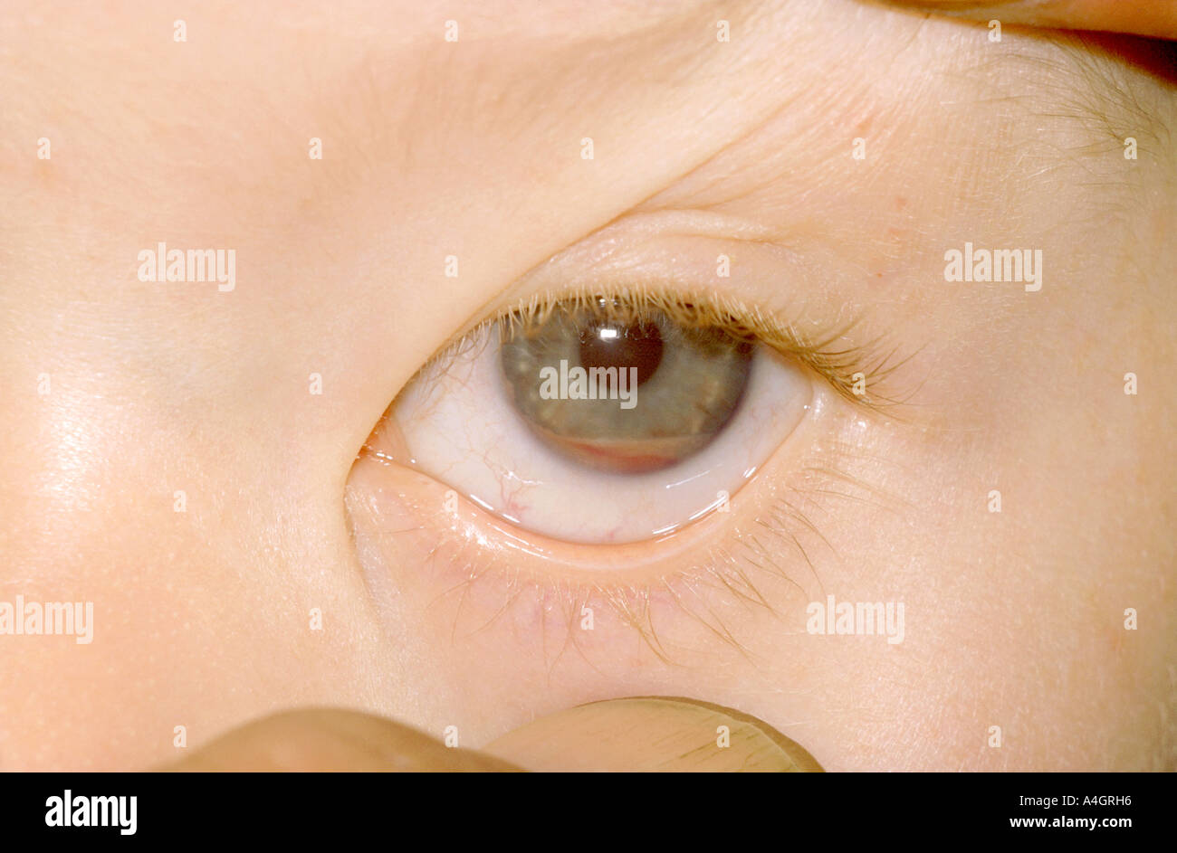 Hyphema hi-res stock photography and images - Alamy