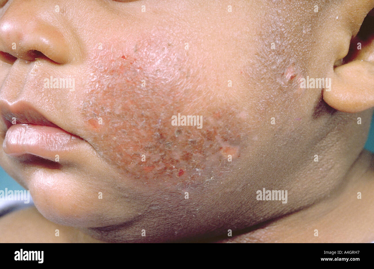 Zinc Deficiency Perioral Dermatitis at Mary Garay blog