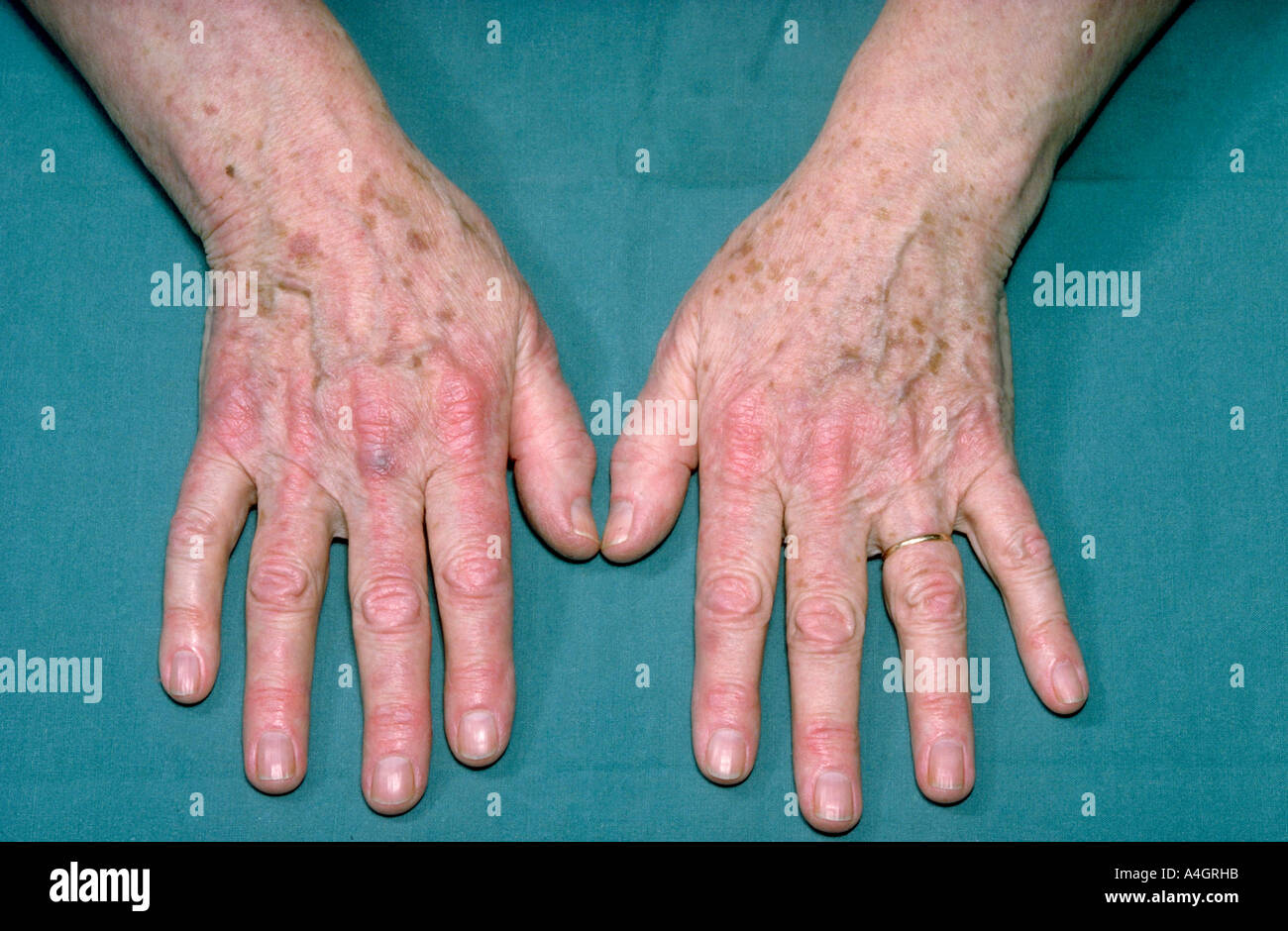 Gottron papules hi-res stock photography and images - Alamy