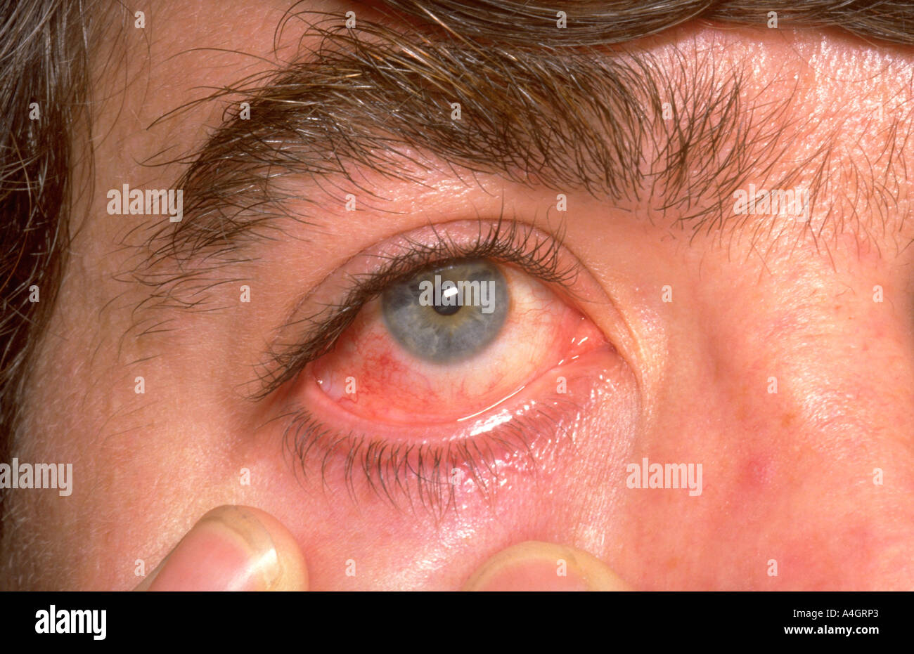 A photograph of a male with conjunctivitis, an inflammation of the ...