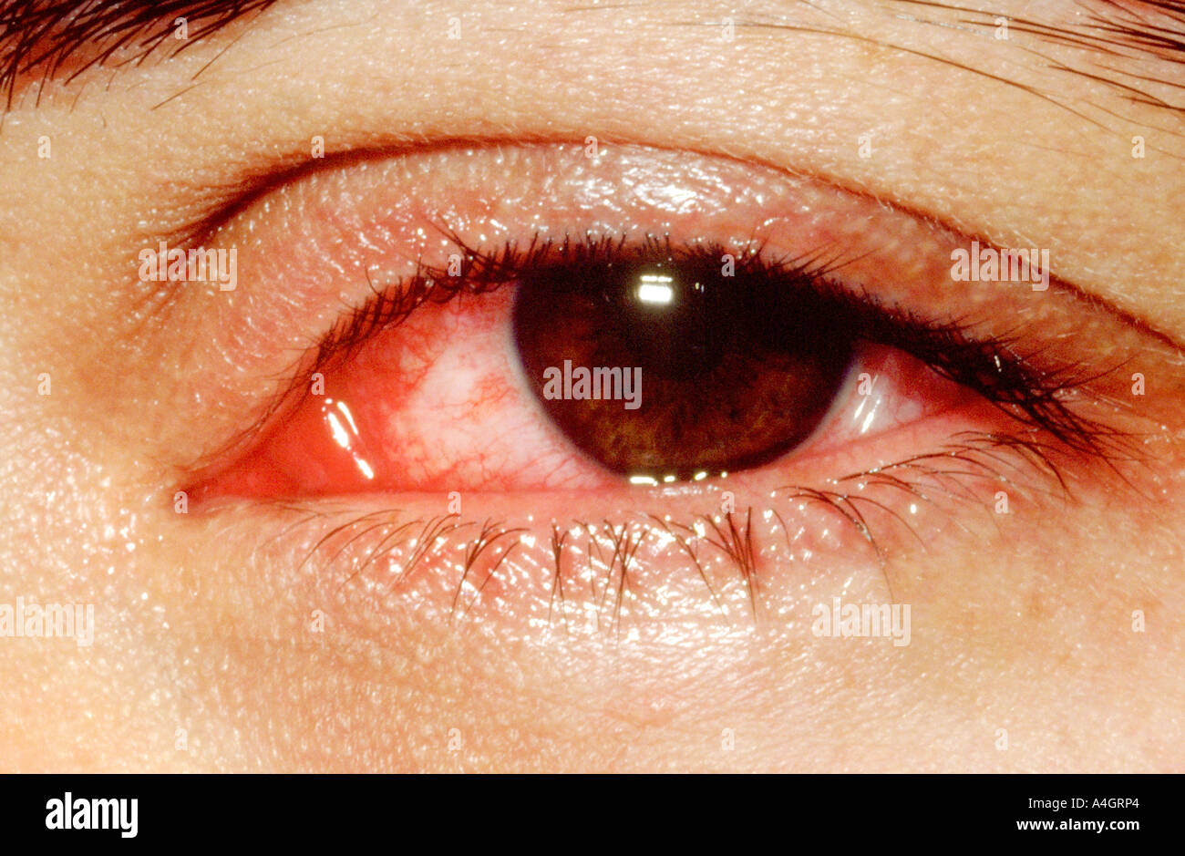Conjunctivitis Stock Photos & Conjunctivitis Stock Images - Alamy
