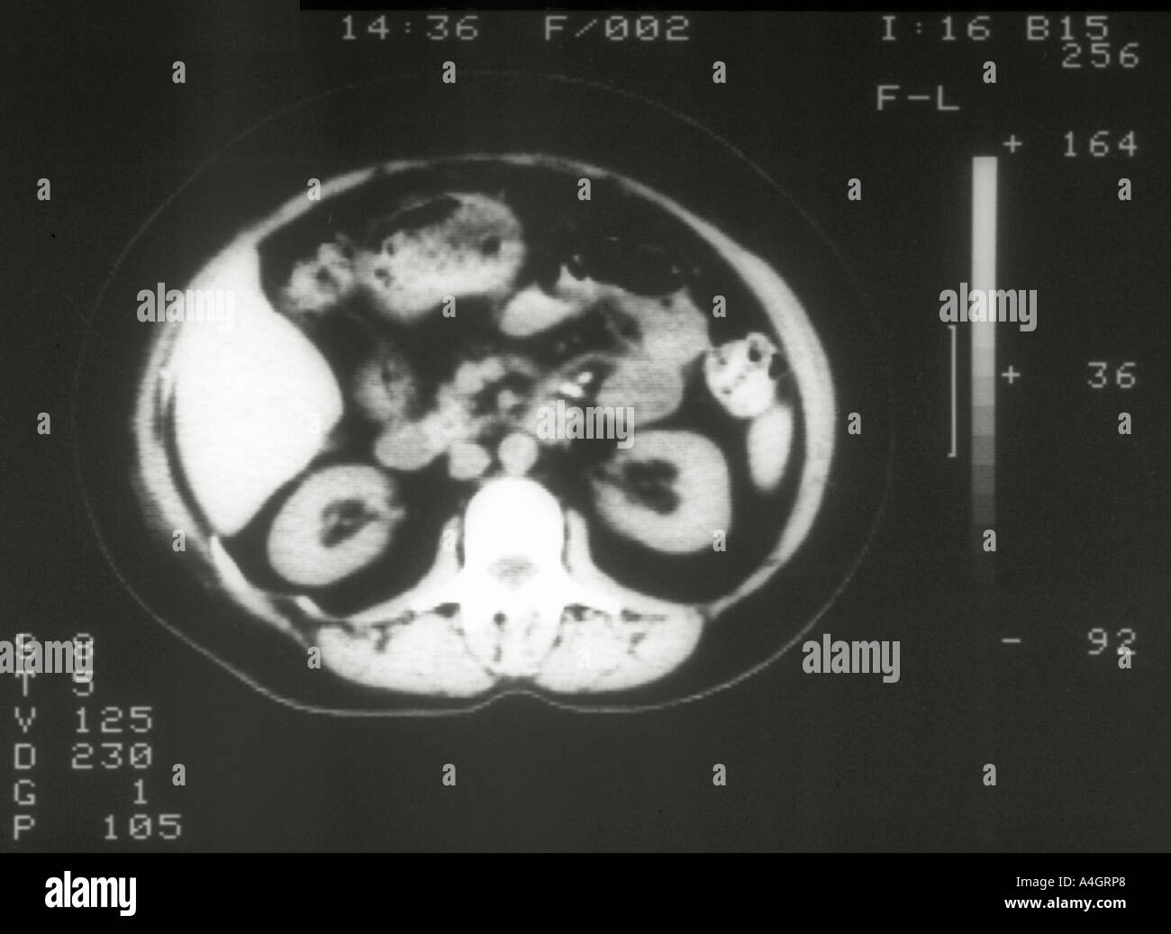 Ct scan abdomen hi-res stock photography and images - Alamy