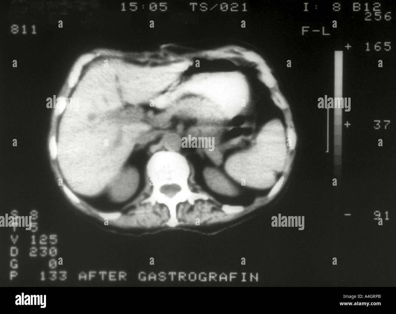 Ct scan abdomen hi-res stock photography and images - Alamy Ct scan abdomen hi-res stock photography and images - Alamy
