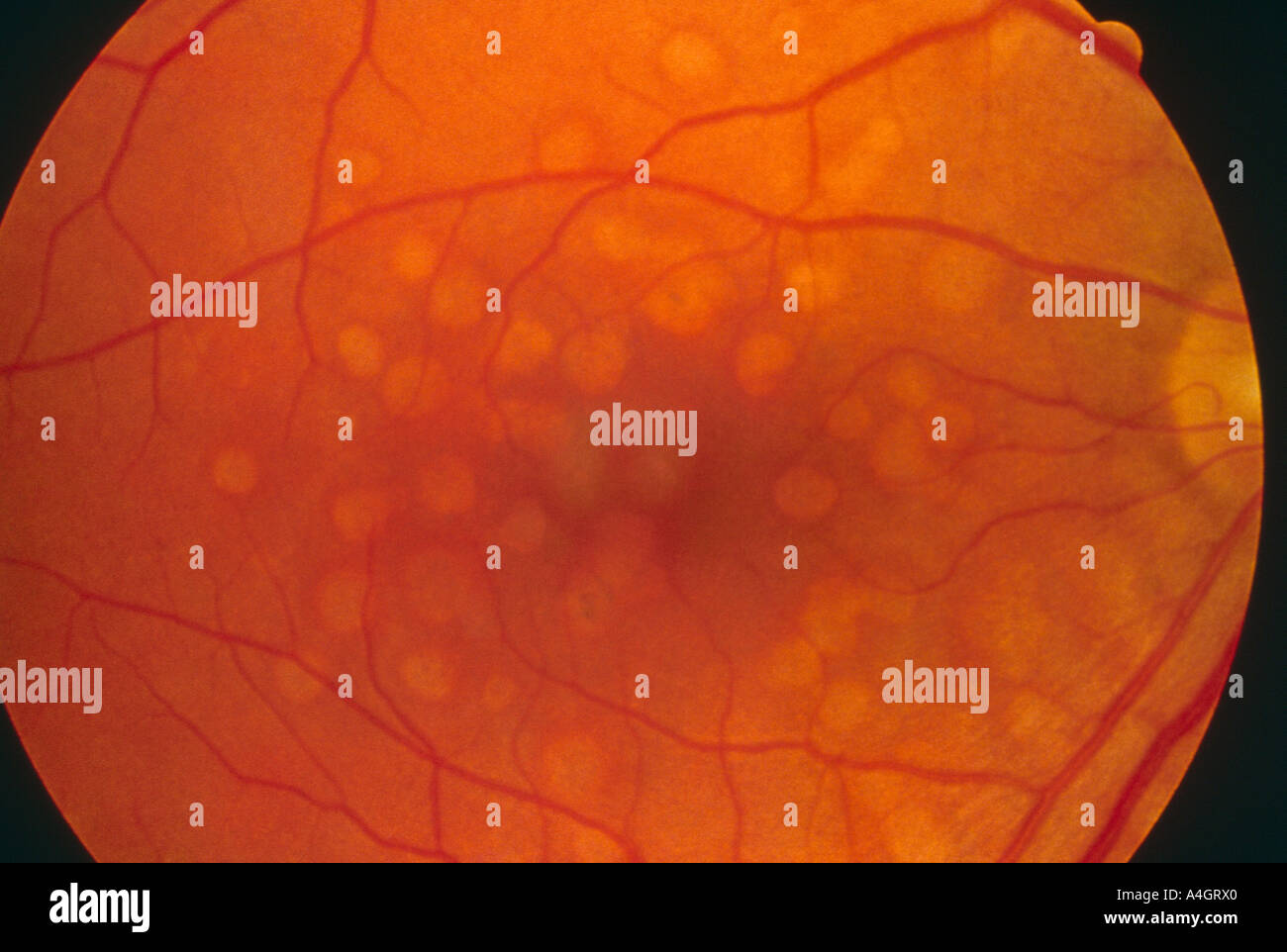 A retinal photograph showing the retina after laser treatment for ...